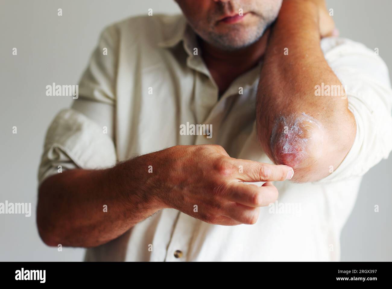 applying an cream emollient to dry flaky skin as in the treatment of ...