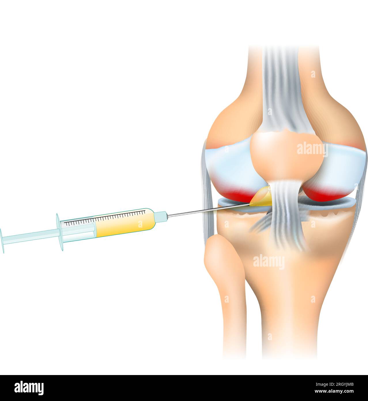 Prp knee injection Cut Out Stock Images & Pictures - Alamy Prp knee injection Cut Out Stock Images & Pictures - Alamy