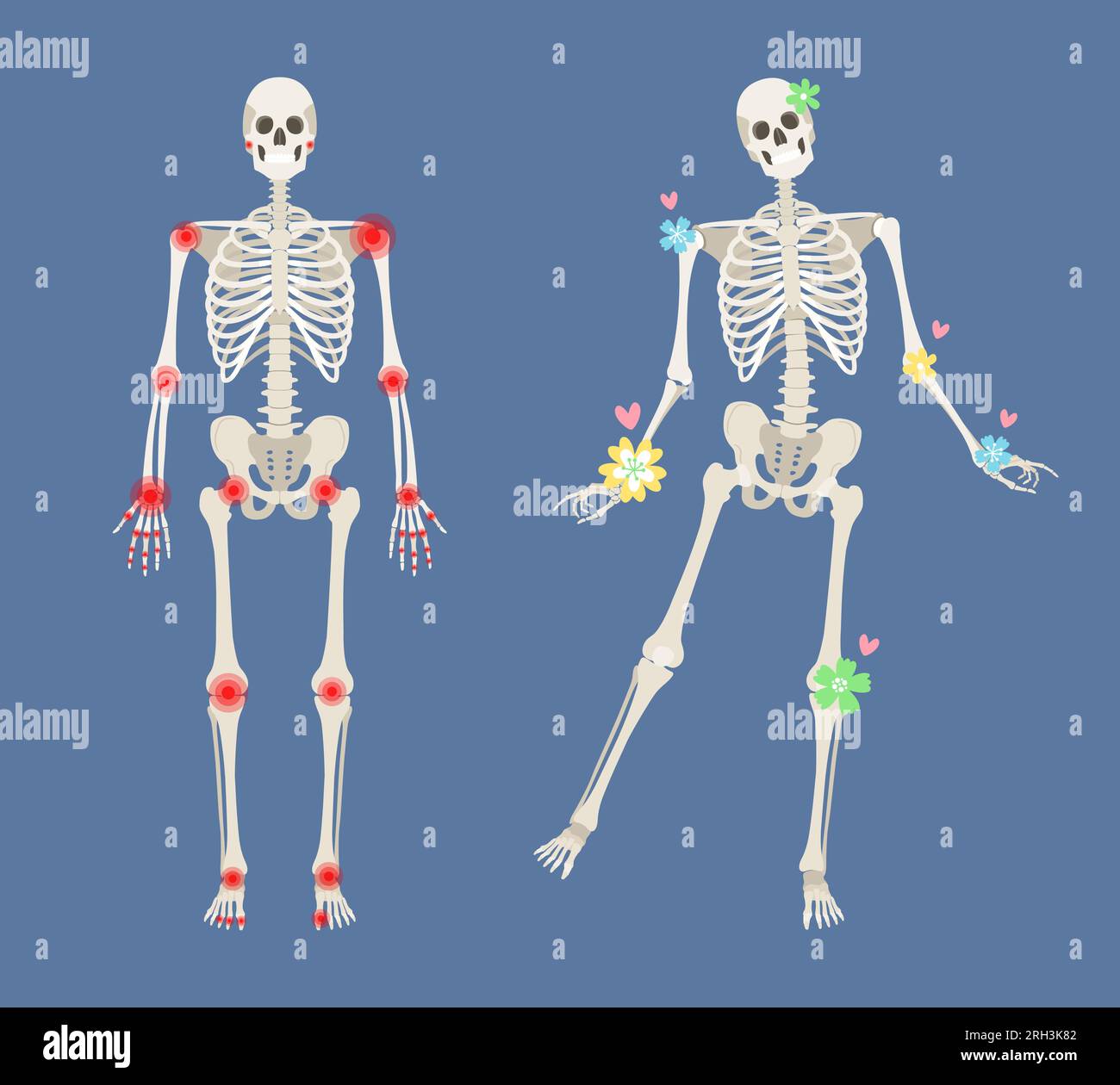 Recovery from autoimmune disease, healthy joints. Human skeleton with ...