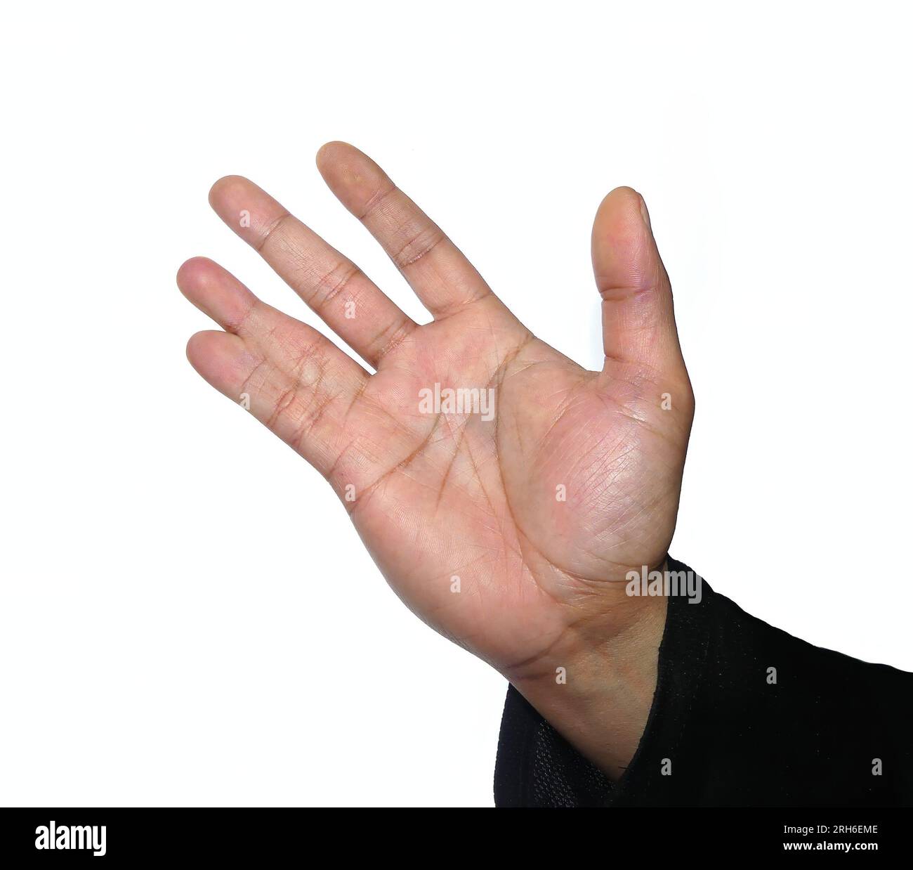 An open hand isolated on a white background, presents a congenital ...
