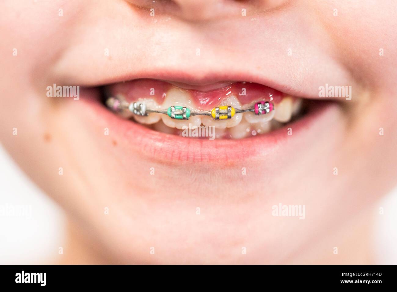 Little girl with rainbow braces Stock Photo - Alamy