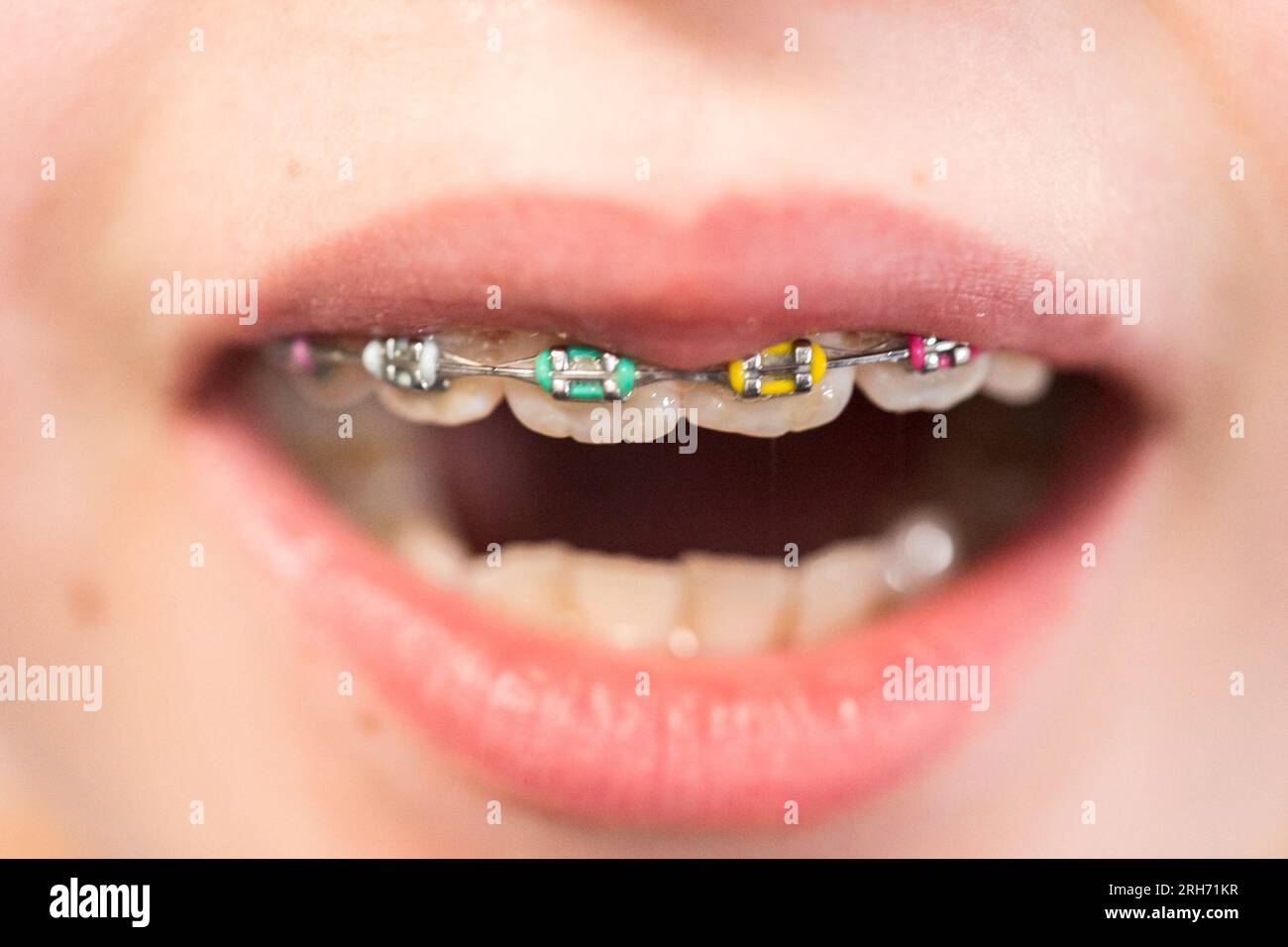 Little girl with rainbow braces Stock Photo - Alamy