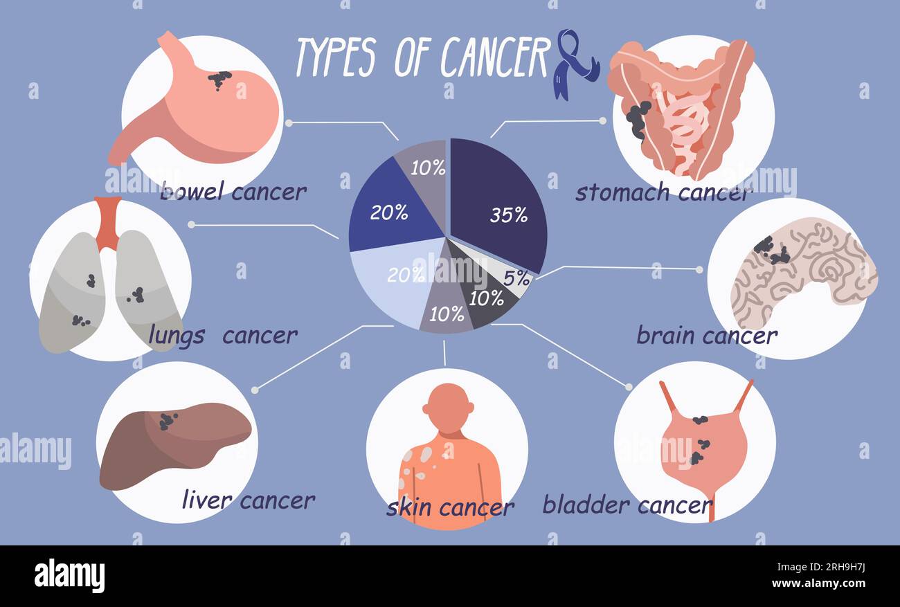 Cancer patient oncology flat infographic composition with radial chart and round compositions ...