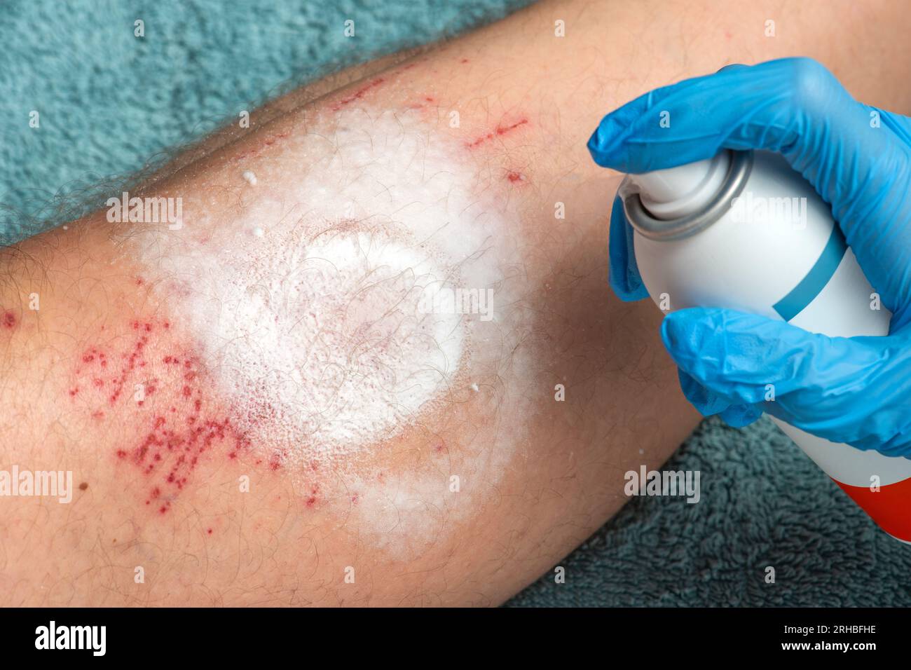 Bicycle injury. The doctor's hand applies disinfectant foam to the leg ...