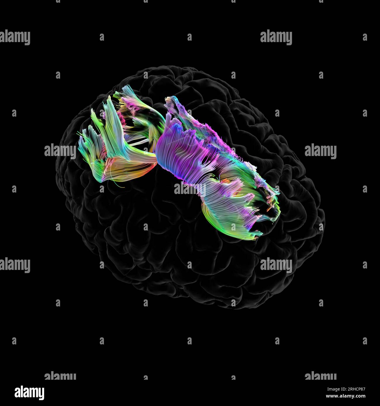 Corpus callosum, DTI MRI scan Stock Photo - Alamy