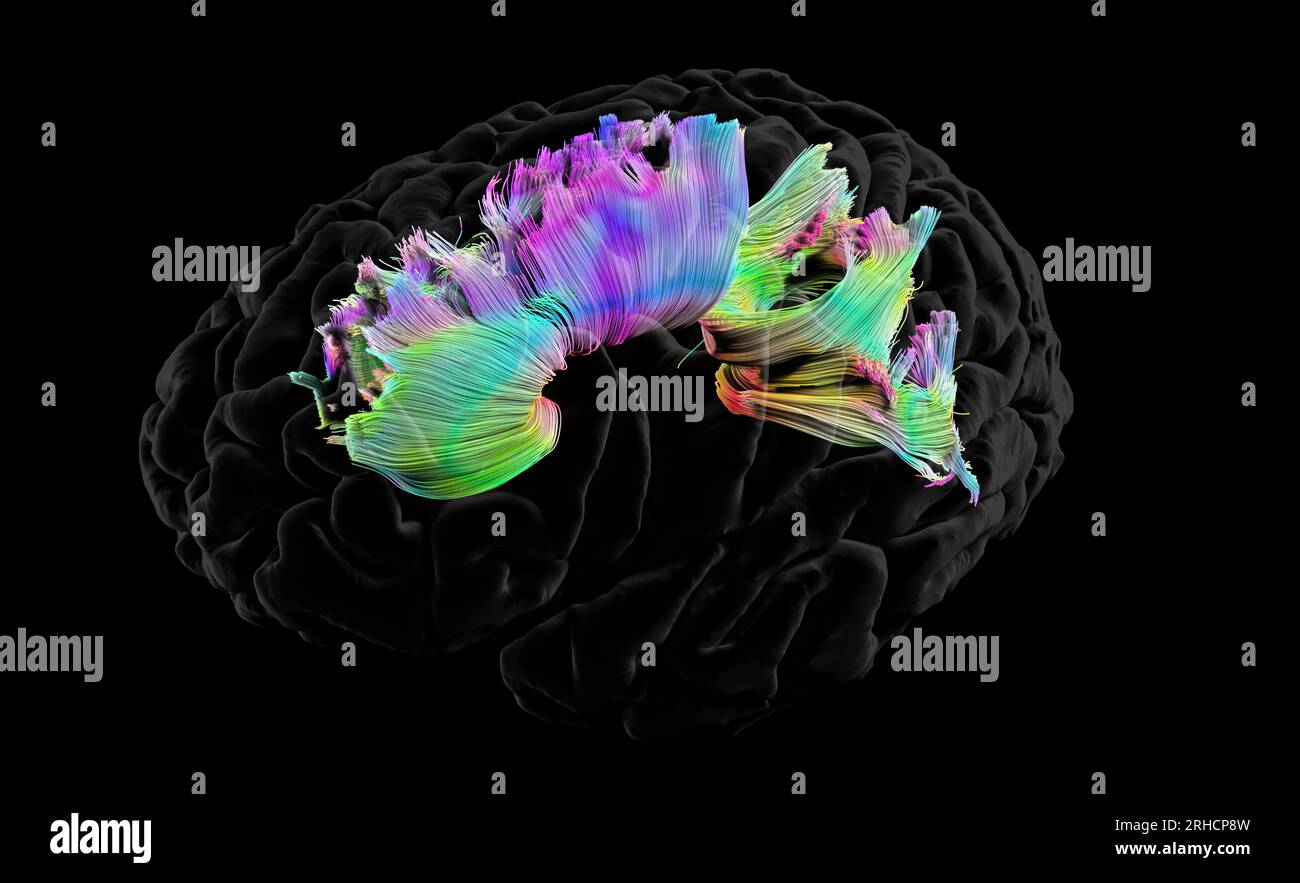 Corpus callosum, DTI MRI scan Stock Photo - Alamy