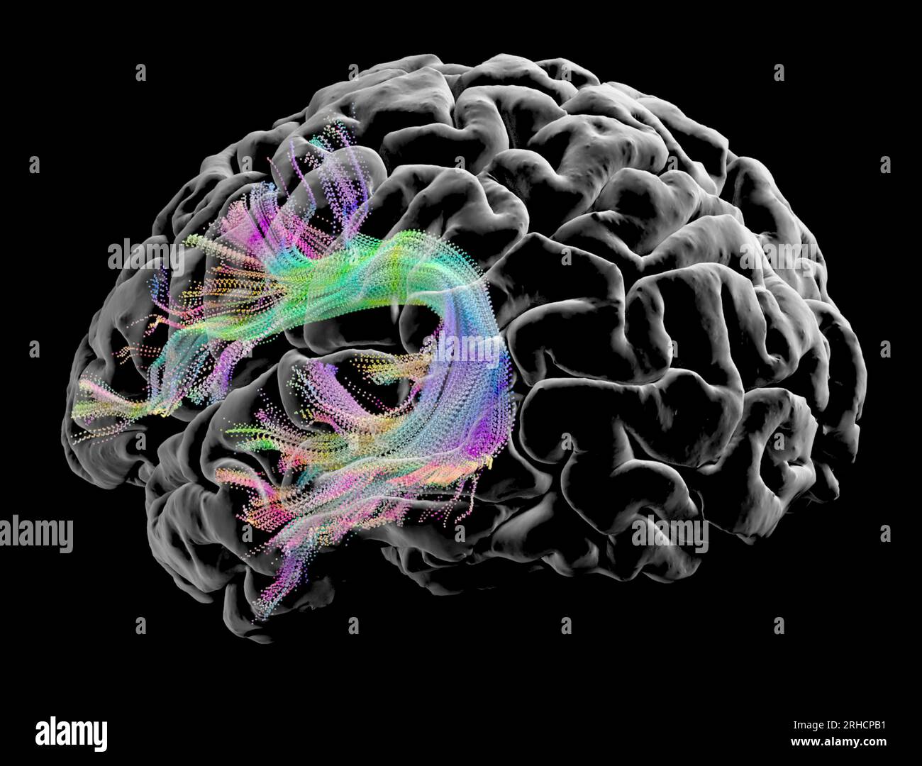 Arcuate fasciculus, DTI MRI scan Stock Photo - Alamy