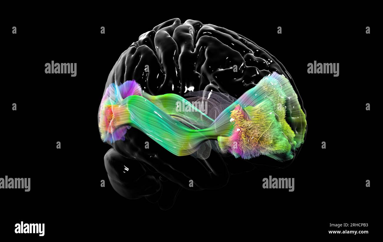 Inferior Parietal Lobule Mri