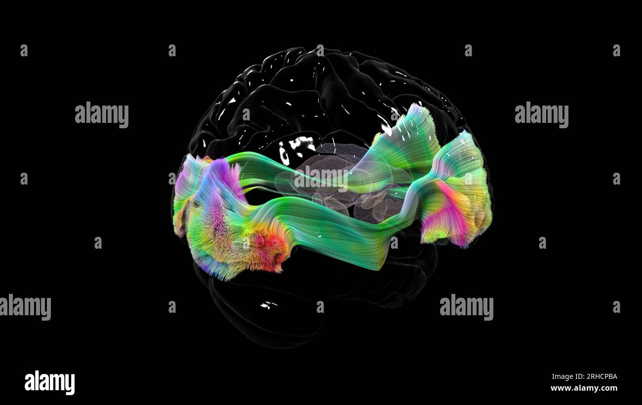 Inferior fronto-occipital fasciculus, DTI MRI scan Stock Photo - Alamy