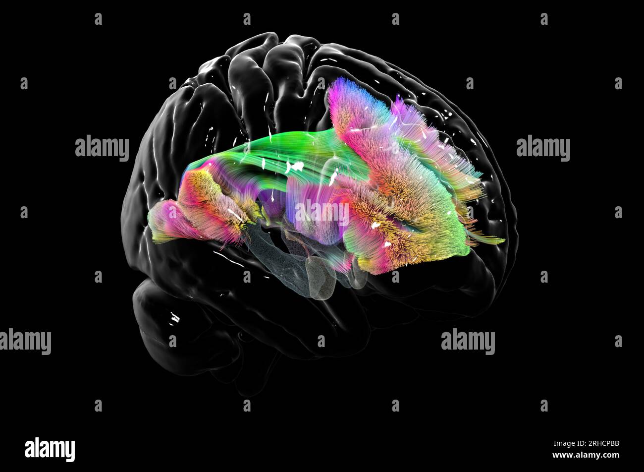 Arcuate fasciculus, DTI MRI scan Stock Photo - Alamy