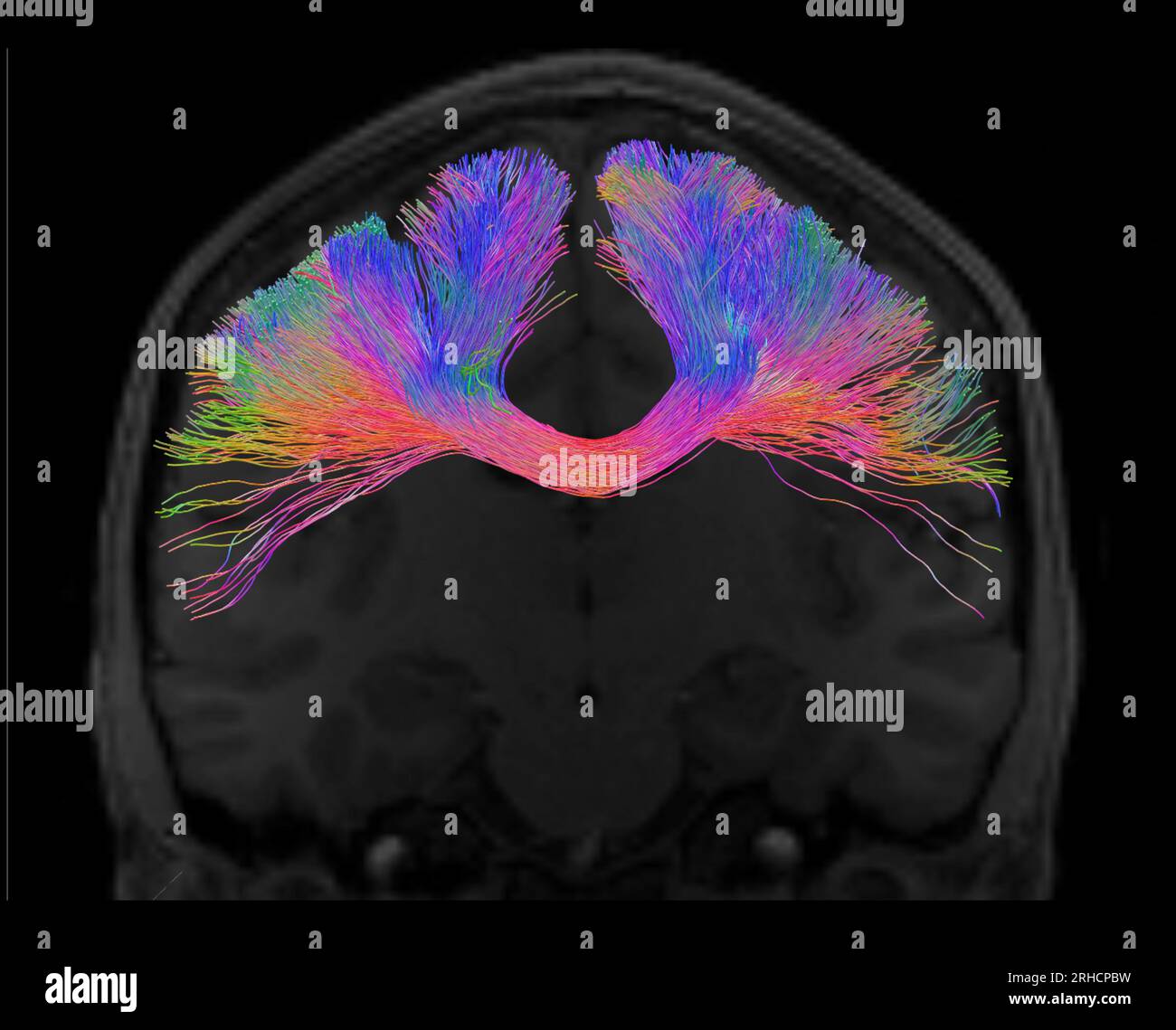Brain's visual pathways, DTI MRI scan Stock Photo - Alamy