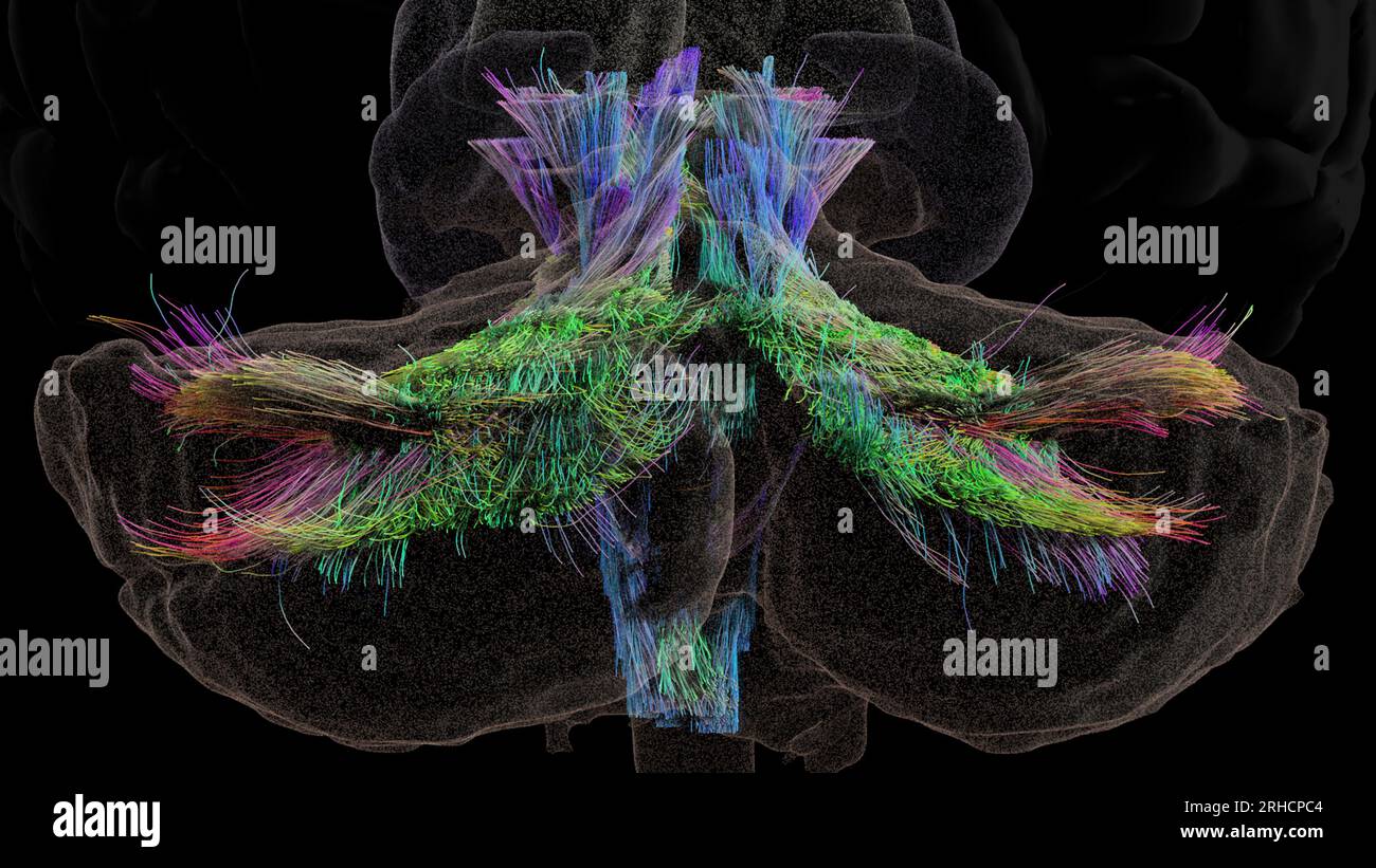 Superior and inferior cerebellar peduncles, DTI MRI scan Stock Photo ...
