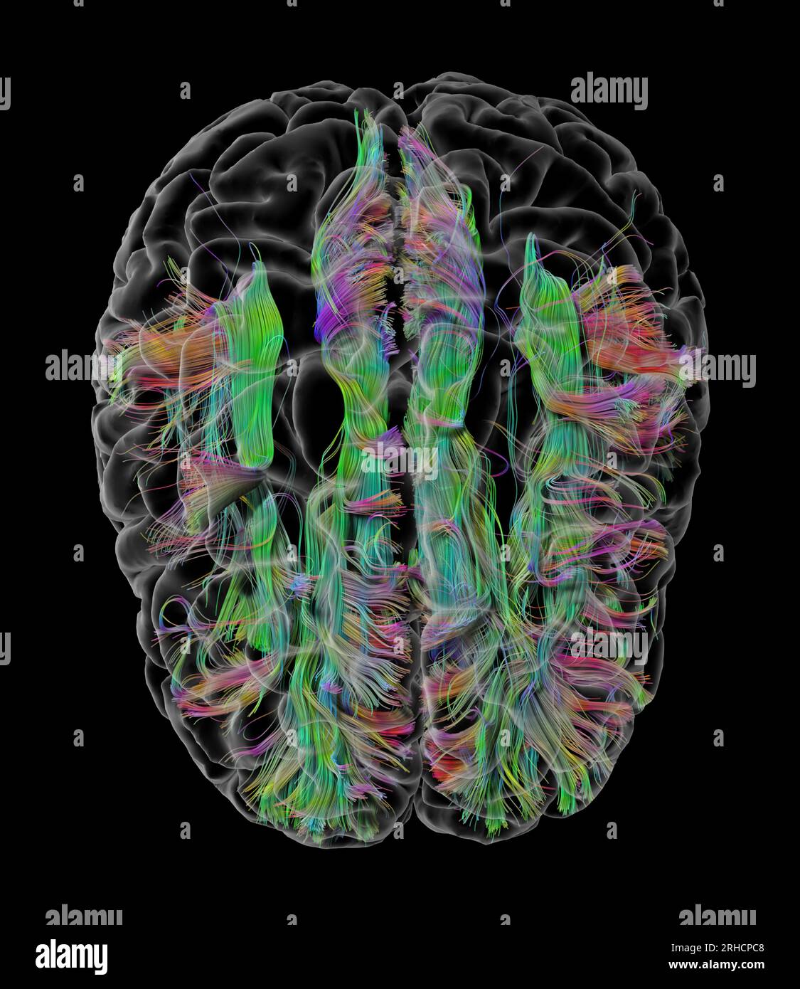 White matter fibres, DTI MRI scan Stock Photo - Alamy