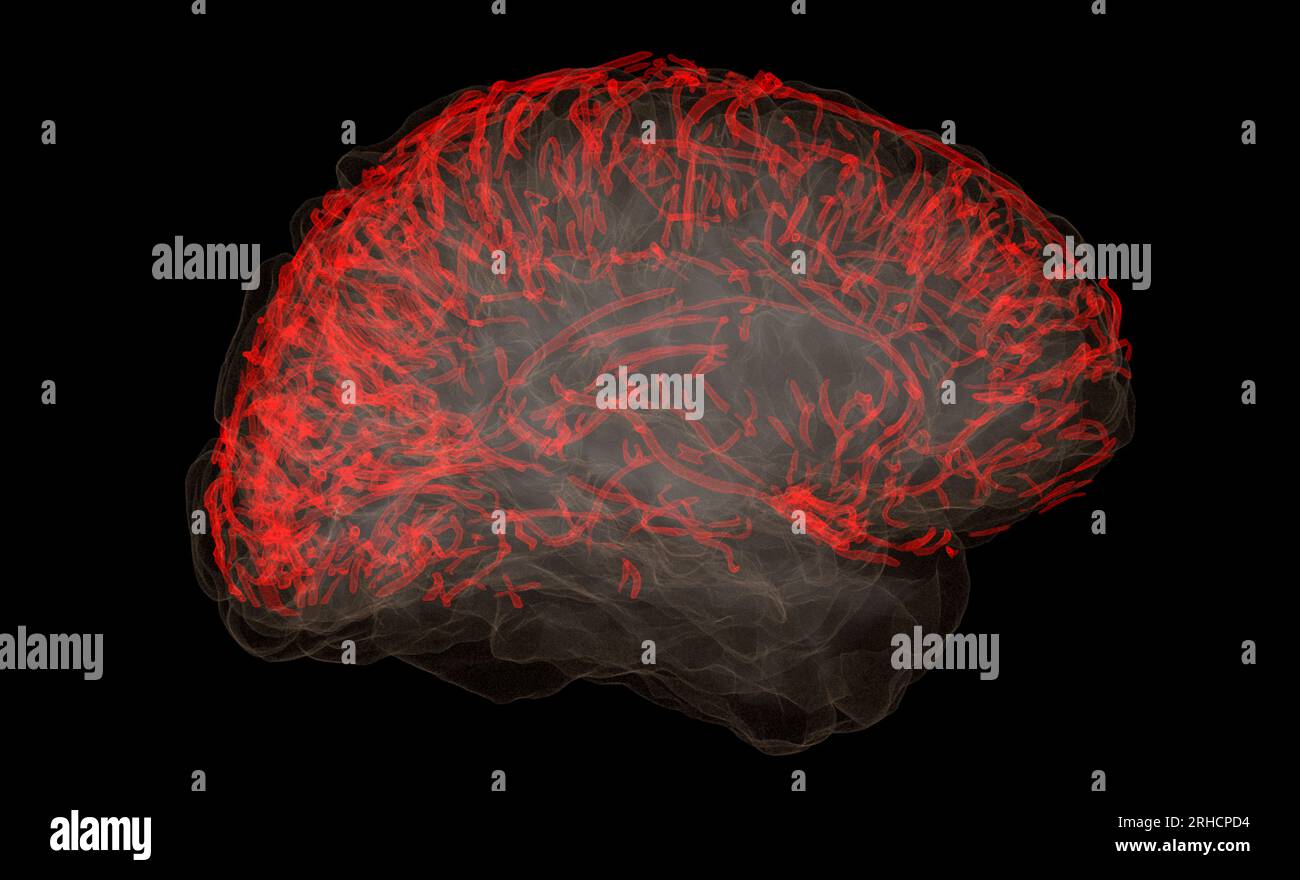 Cerebral blood vessels, MRI angiogram scan Stock Photo - Alamy