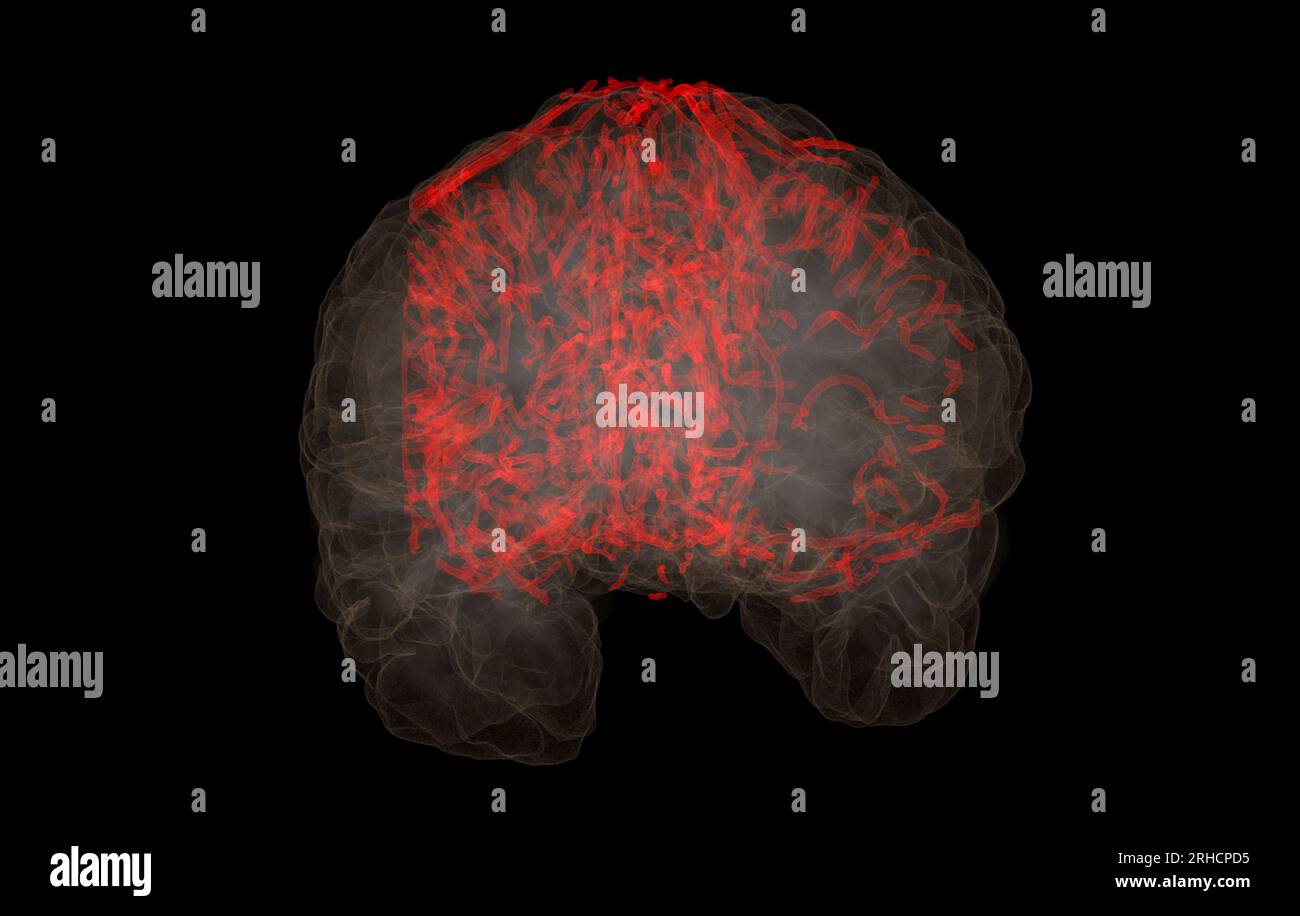 Cerebral blood vessels, MRI angiogram scan Stock Photo - Alamy