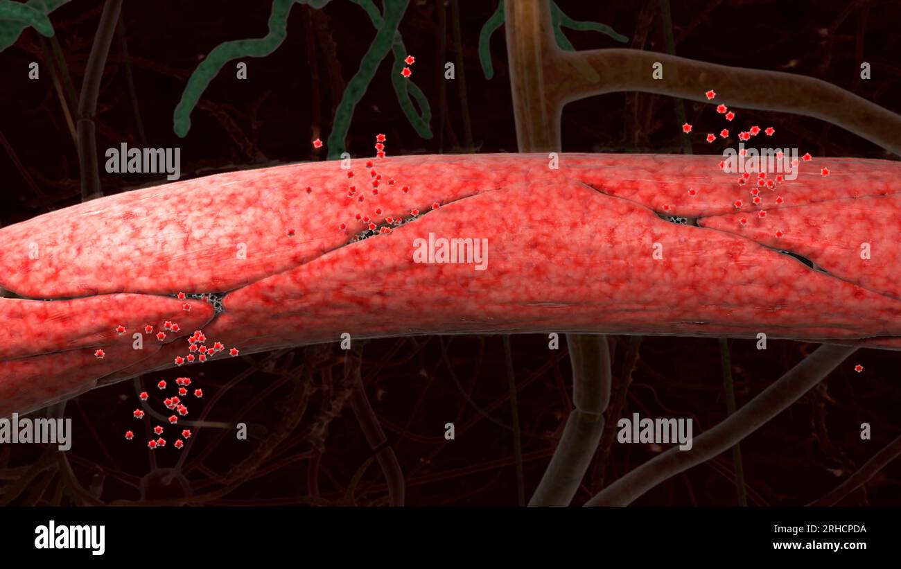 Damaged brain capillary, illustration Stock Photo - Alamy