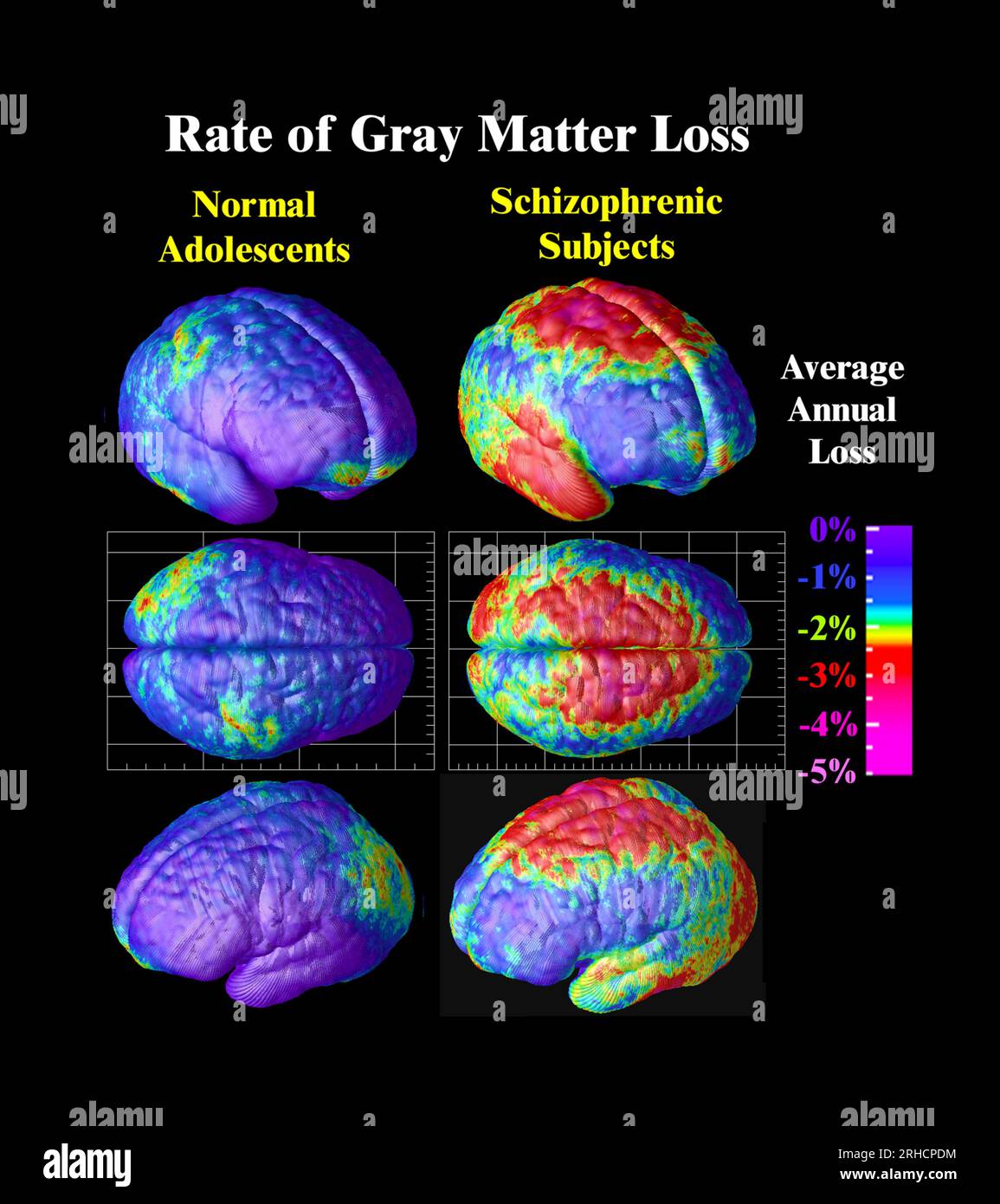 Grey matter loss in very early-onset schizophrenia, brain maps Stock ...