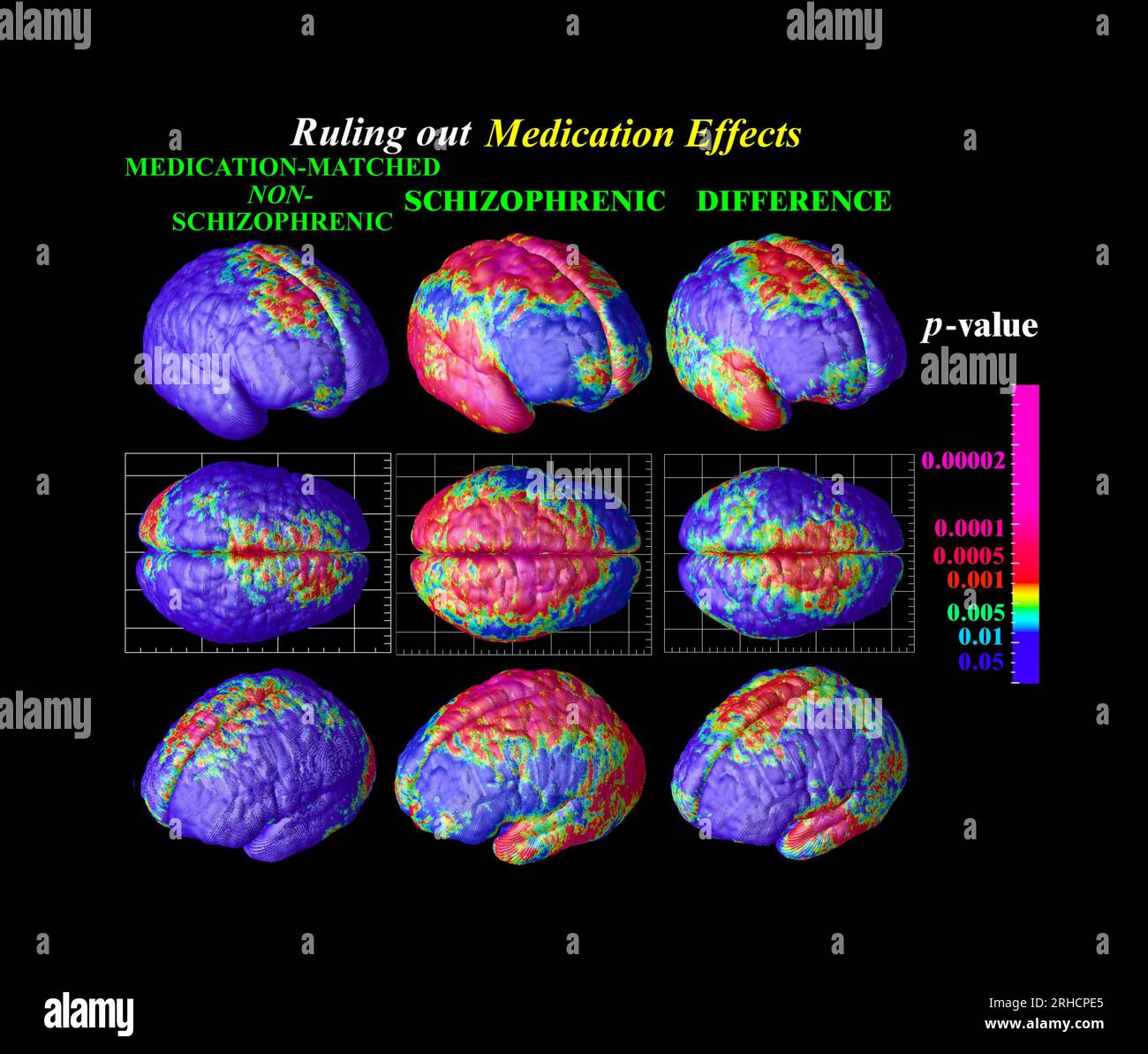 Grey matter loss in very early-onset schizophrenia, brain maps Stock ...
