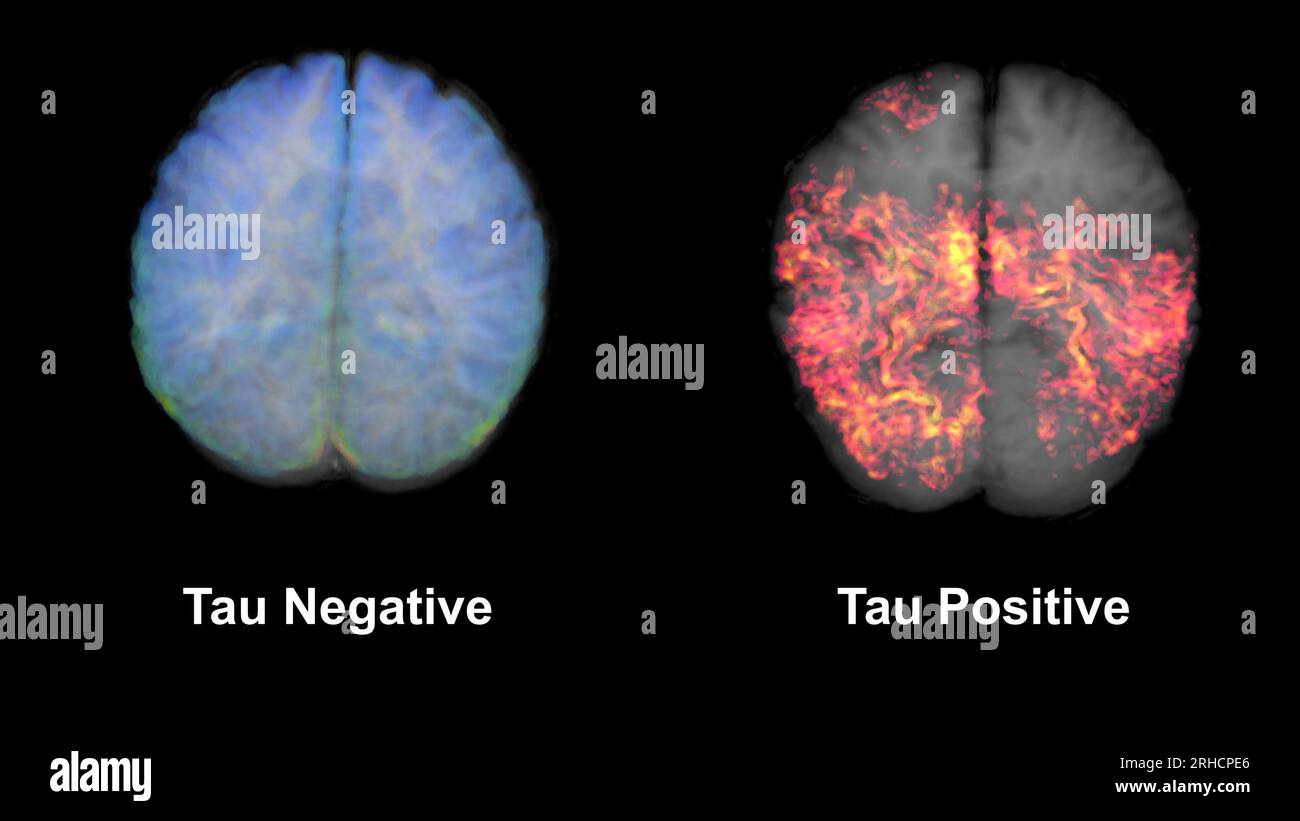 Healthy brain and brain with tau aggregations, MRI scans Stock Photo ...