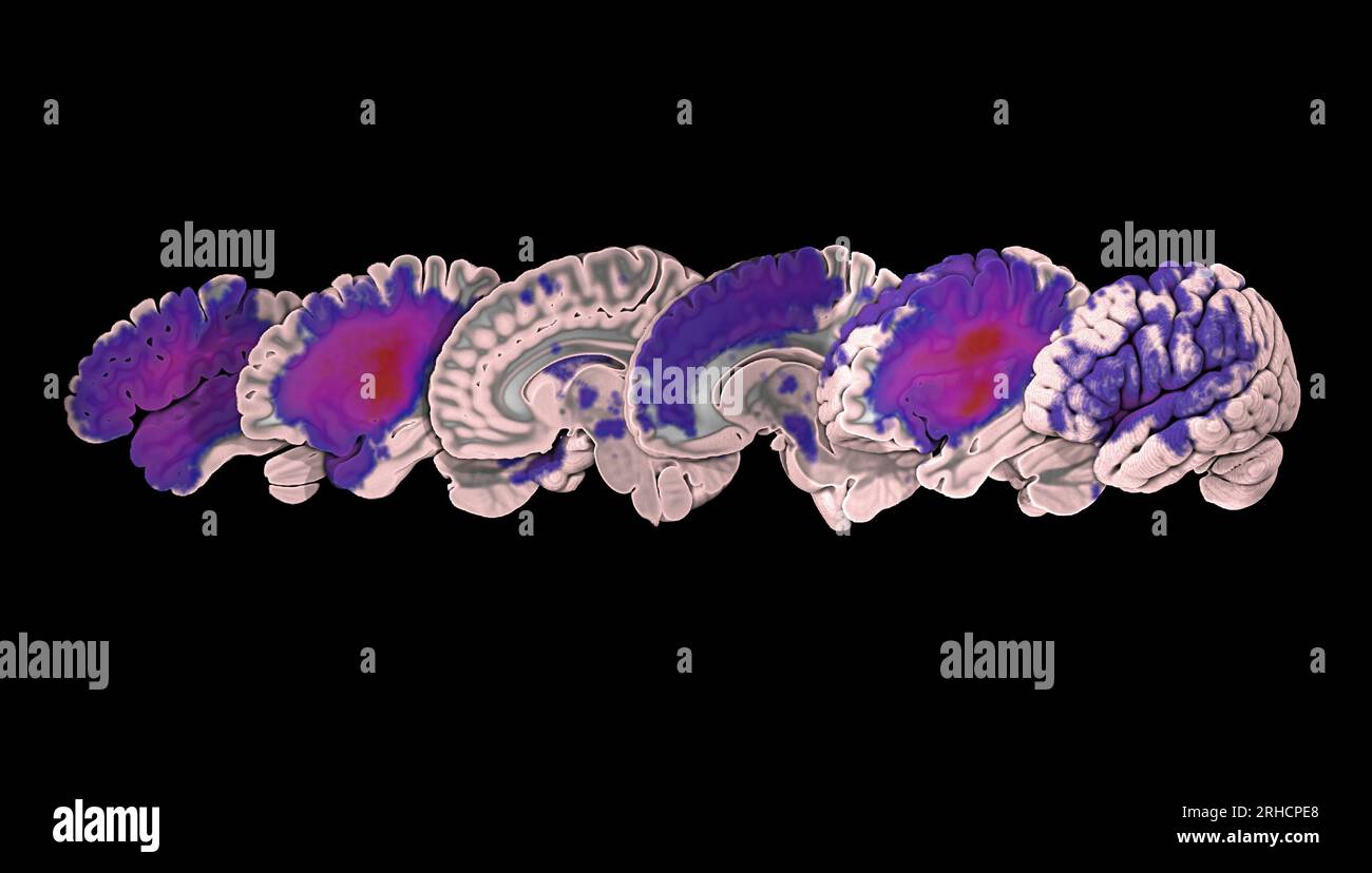 Distribution of stroke lesions, MRI scans Stock Photo - Alamy