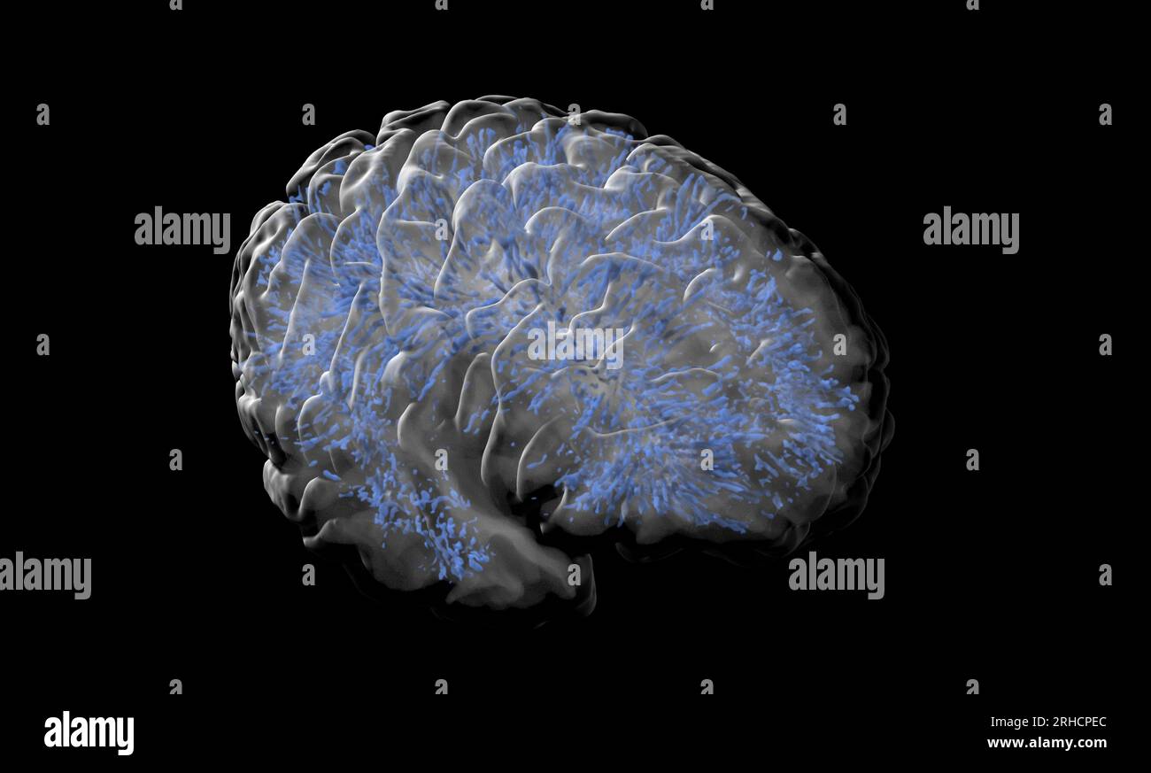 Perivascular spaces, MRI scan Stock Photo - Alamy