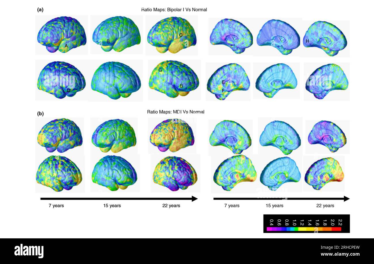Brain development before and after paediatric bipolar disorder, MRI ...