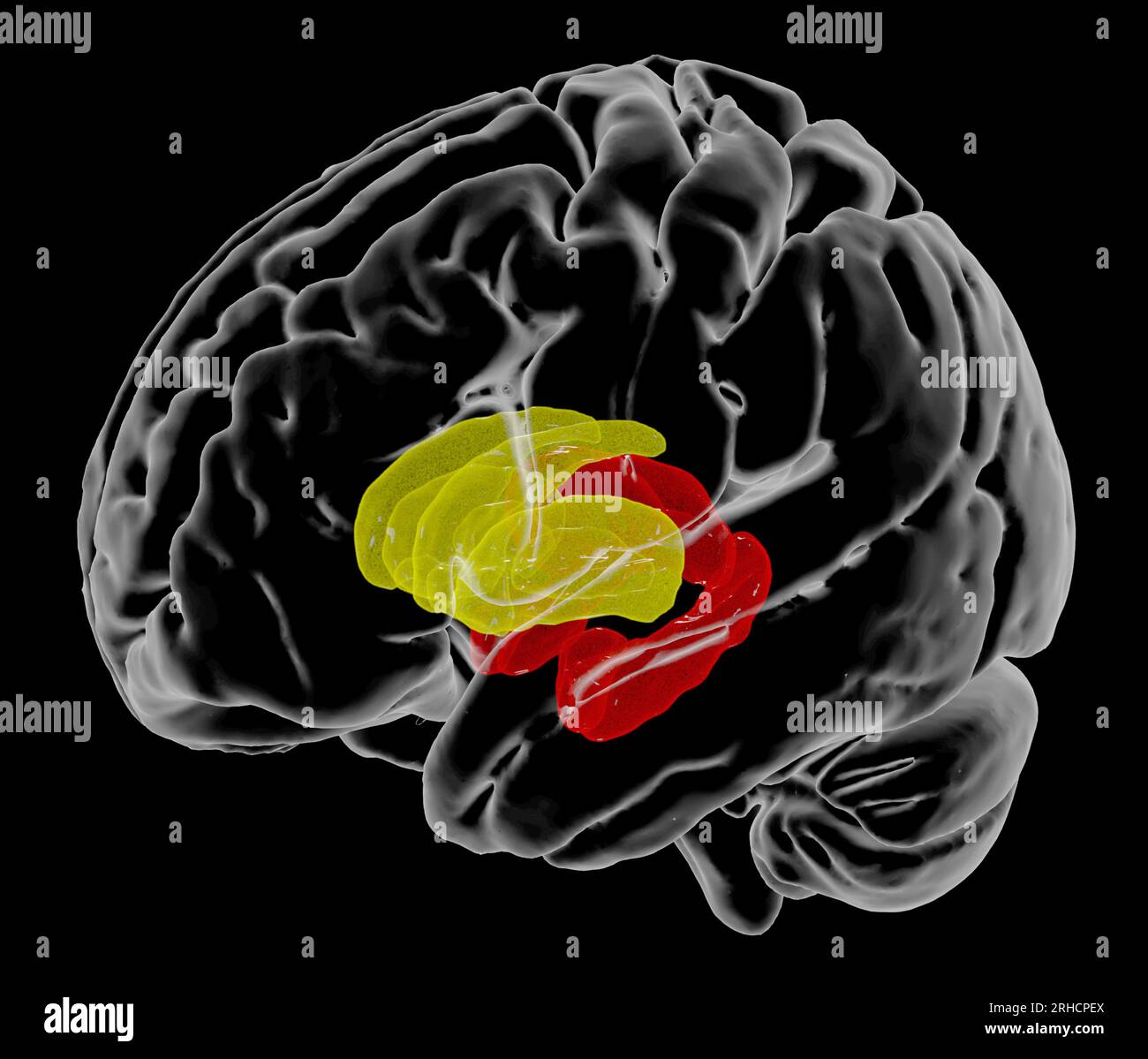 Brain areas affected by HIV, MRI scan Stock Photo - Alamy