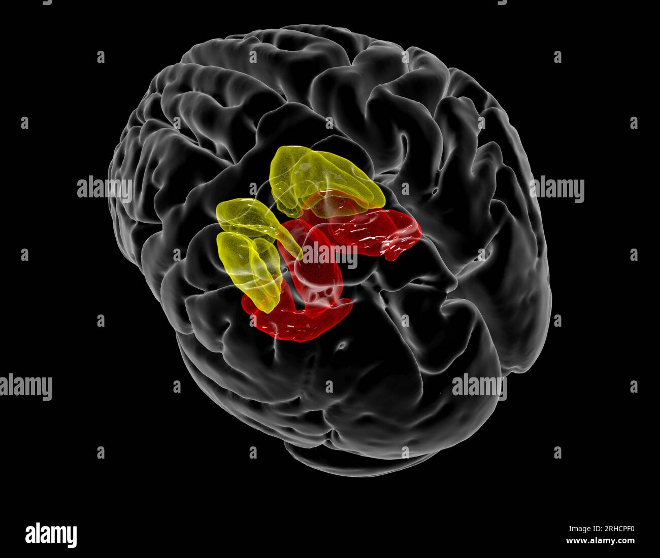 Brain areas affected by HIV, MRI scan Stock Photo - Alamy