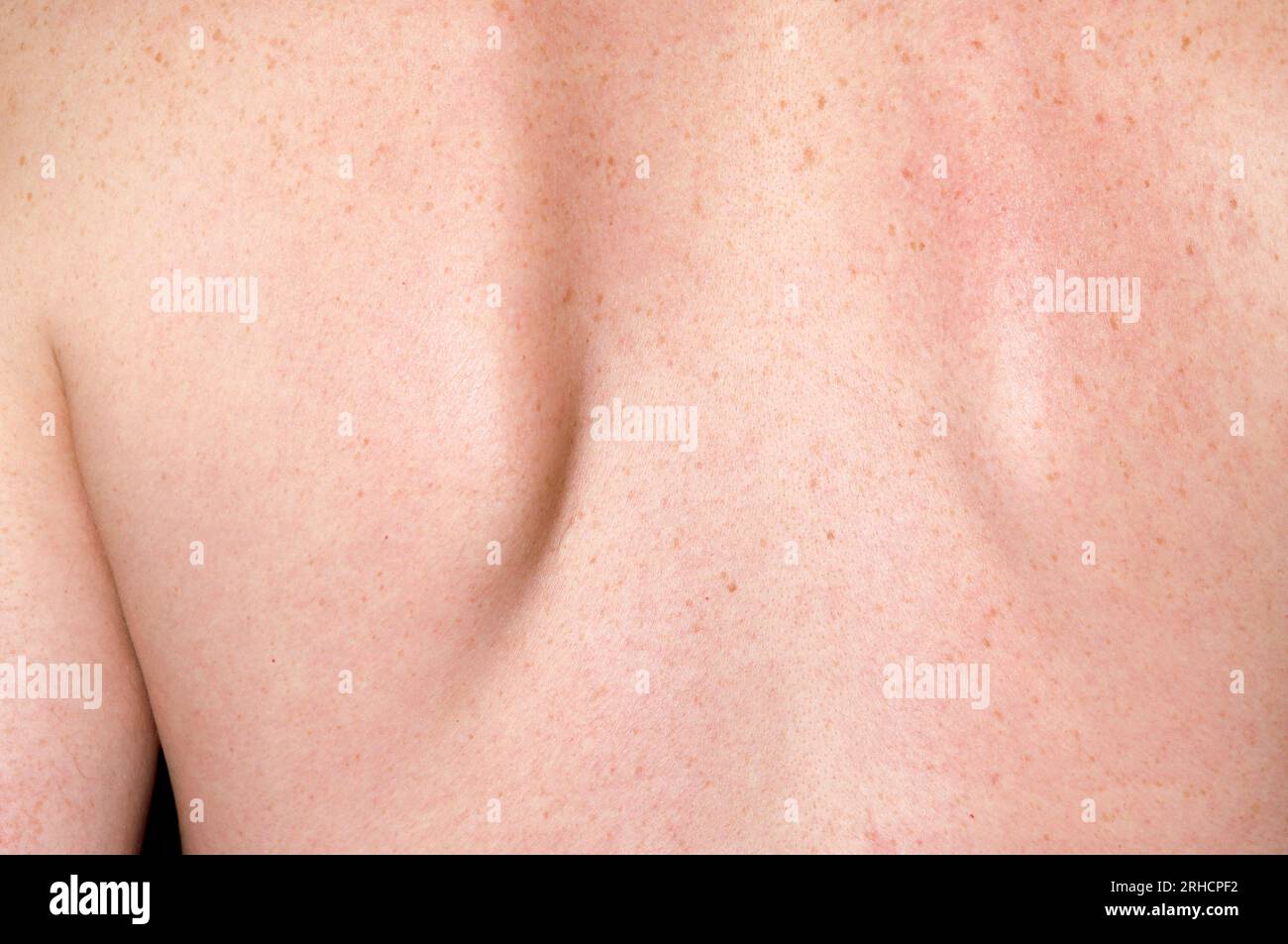 Winged shoulder blade Stock Photo - Alamy