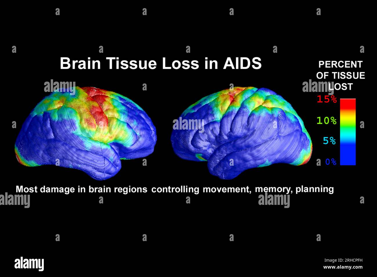 Brain tissue loss in AIDS, MRI scans Stock Photo - Alamy