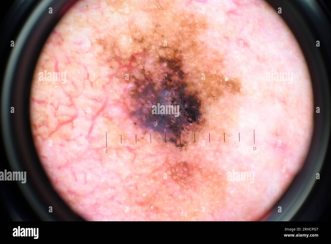 Lentigo maligna melanoma, dermoscopy Stock Photo - Alamy