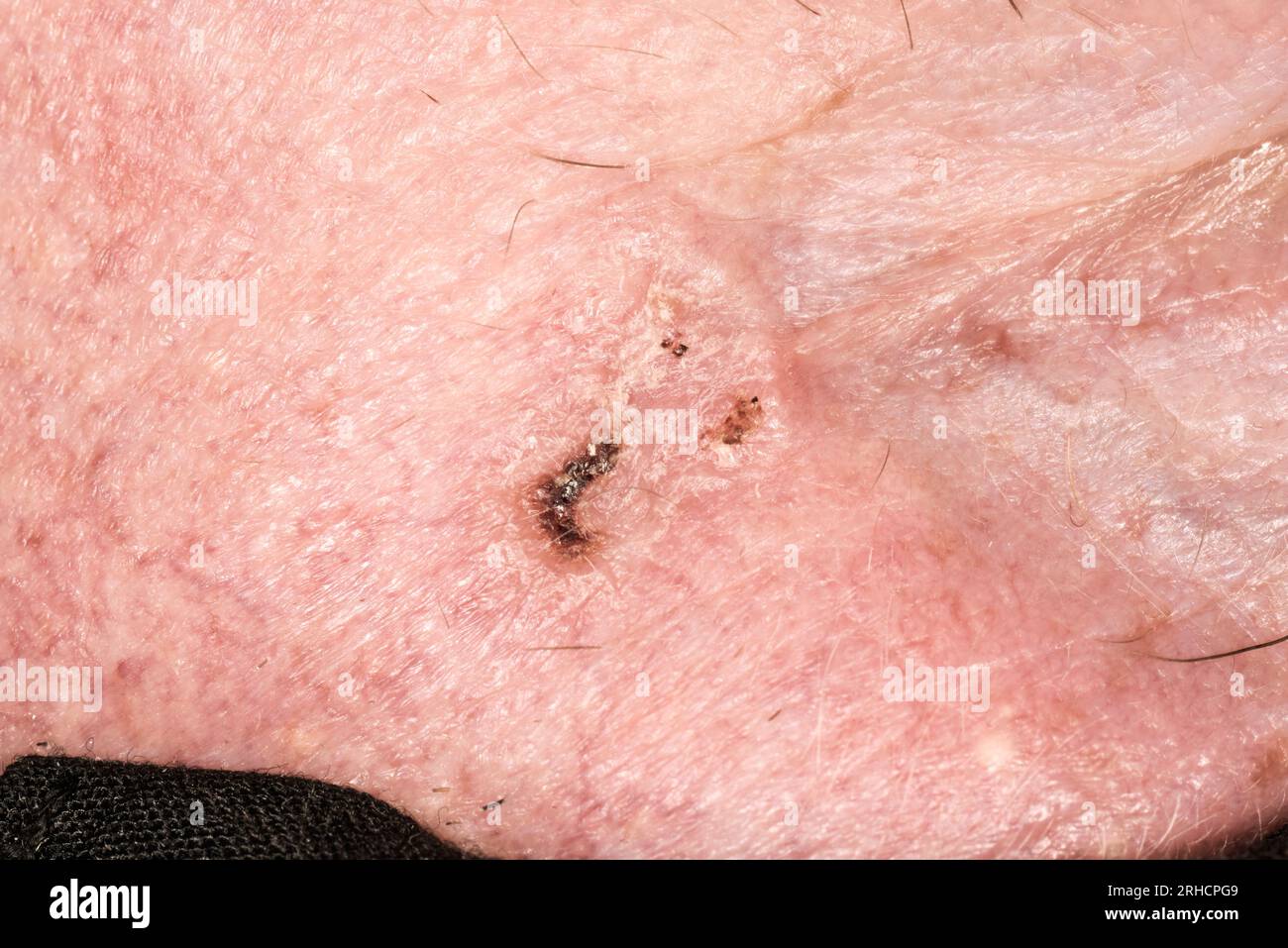Basal cell carcinoma Stock Photo - Alamy