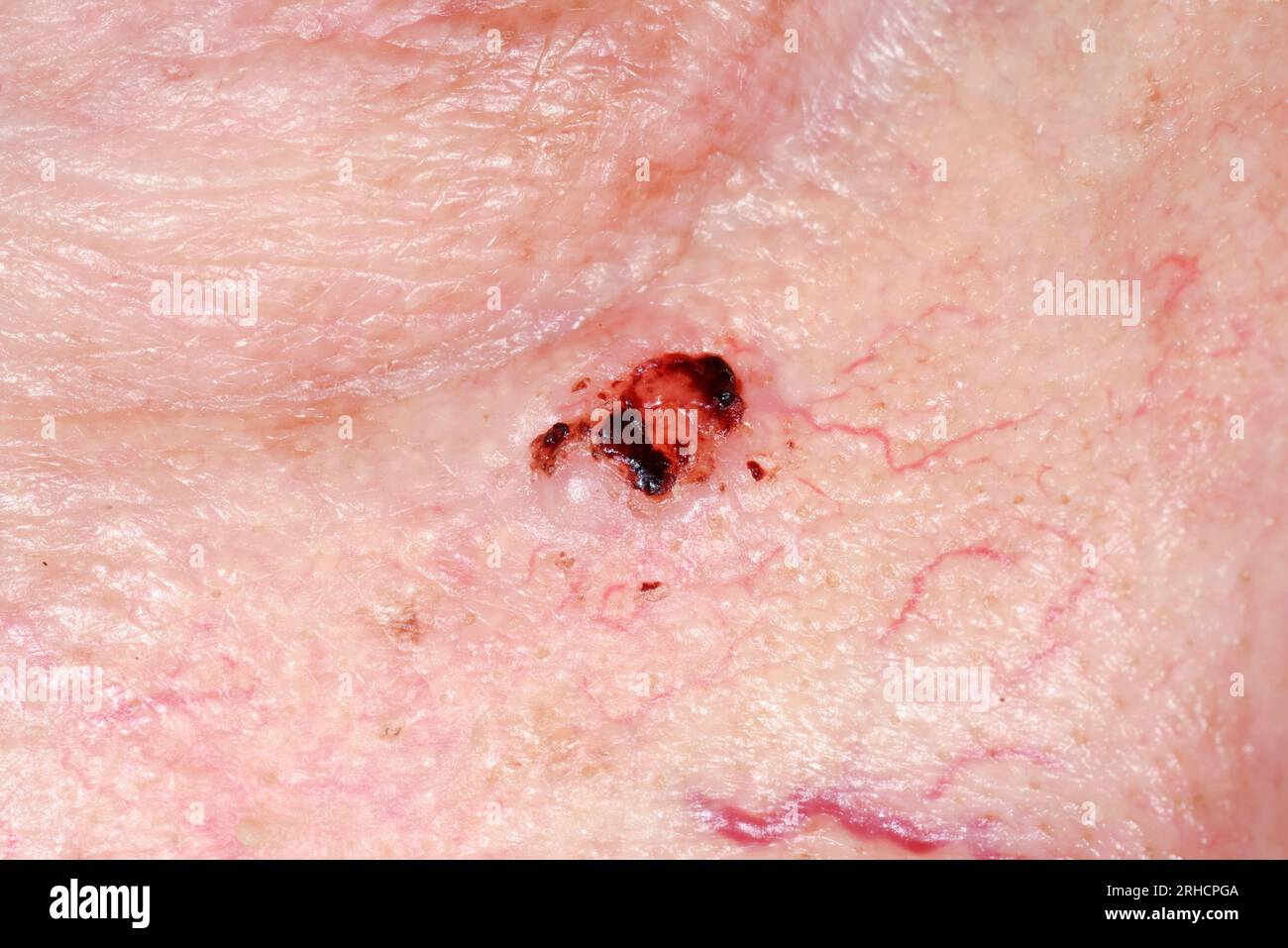 Basal cell carcinoma Stock Photo - Alamy