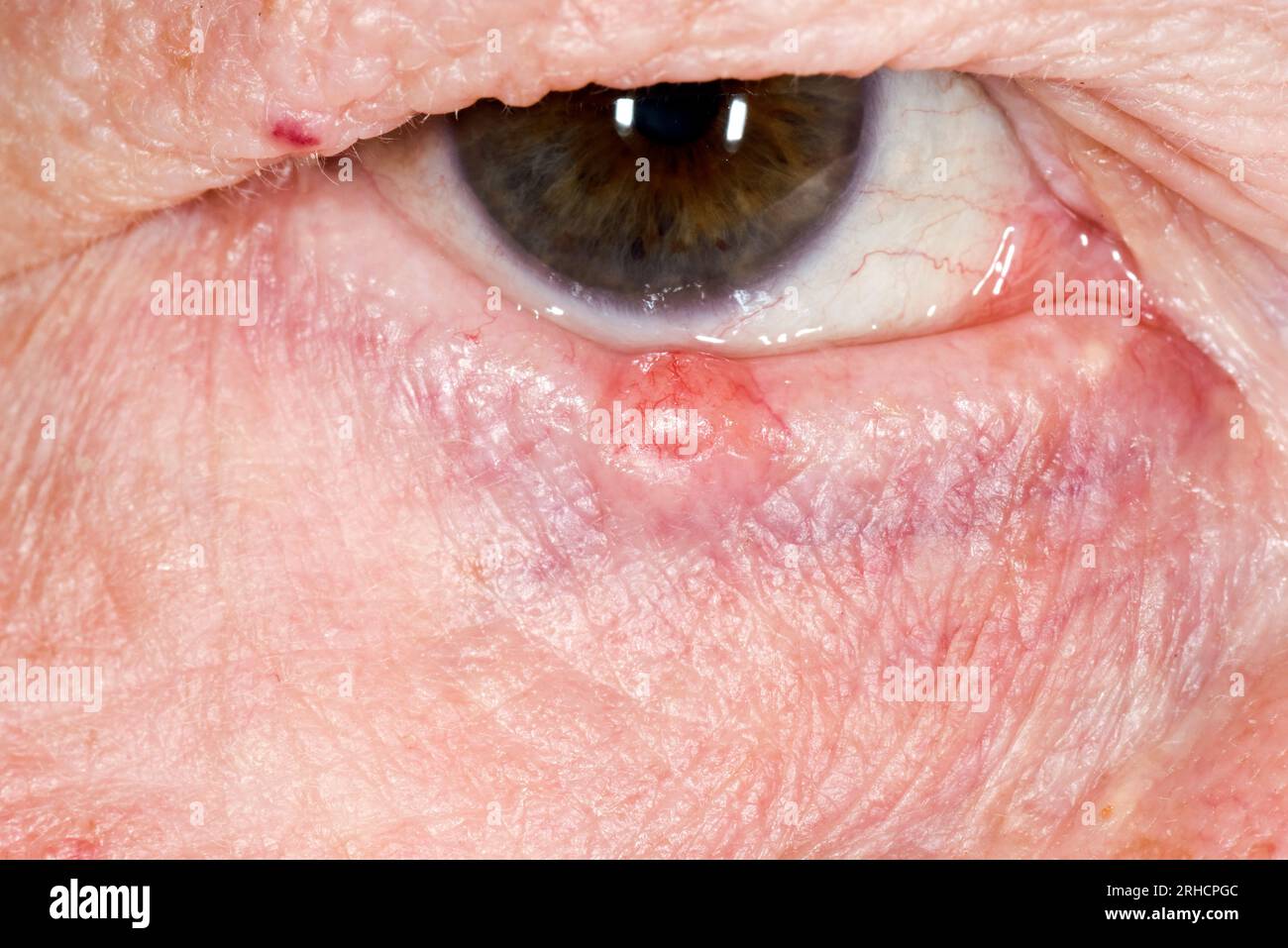 Basal cell carcinoma Stock Photo - Alamy