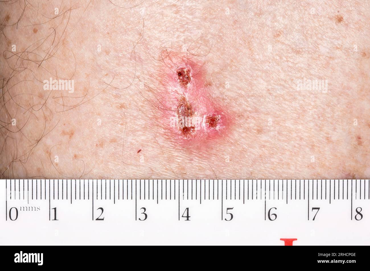Basal cell carcinoma Stock Photo - Alamy