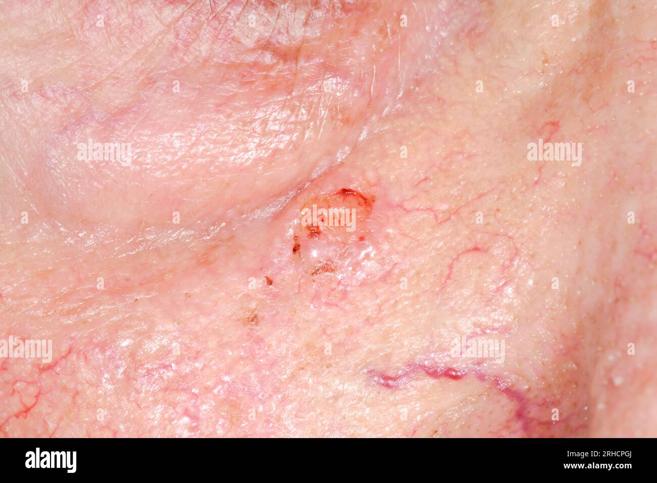 Basal cell carcinoma Stock Photo - Alamy