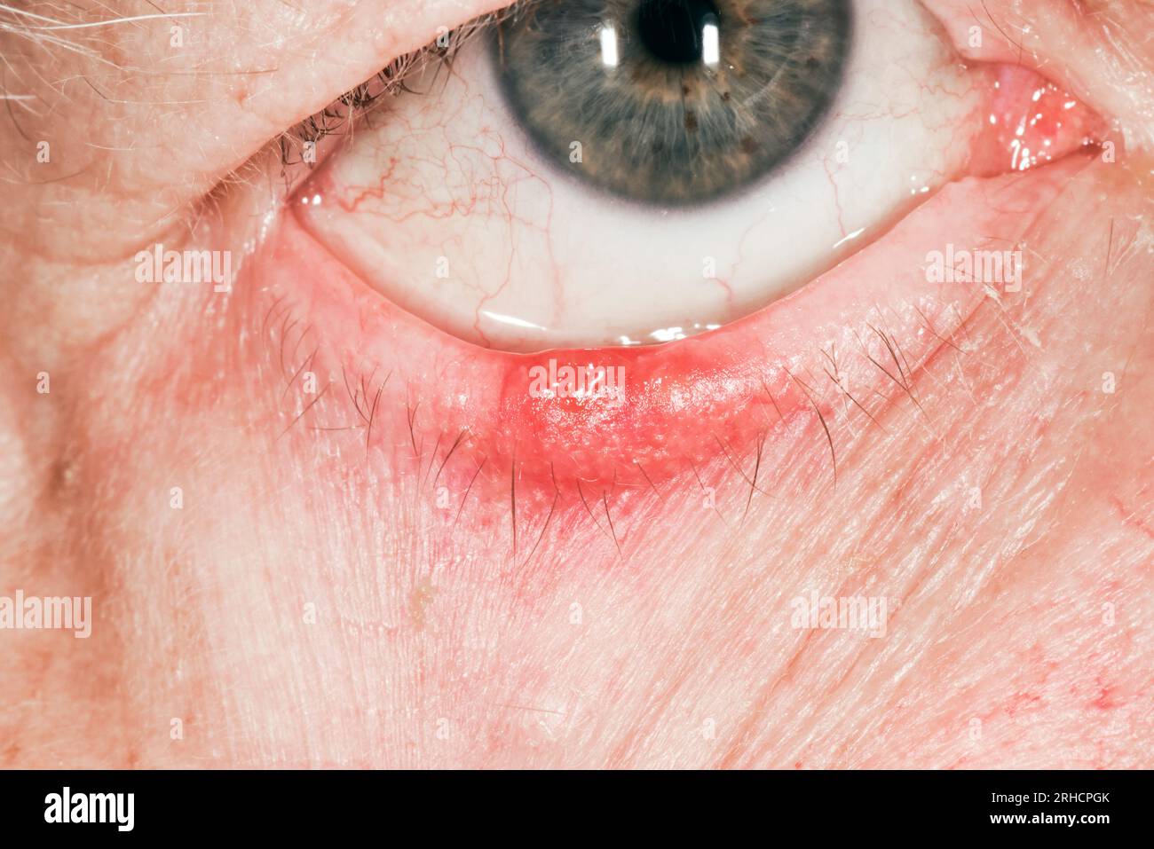 Basal cell carcinoma Stock Photo - Alamy
