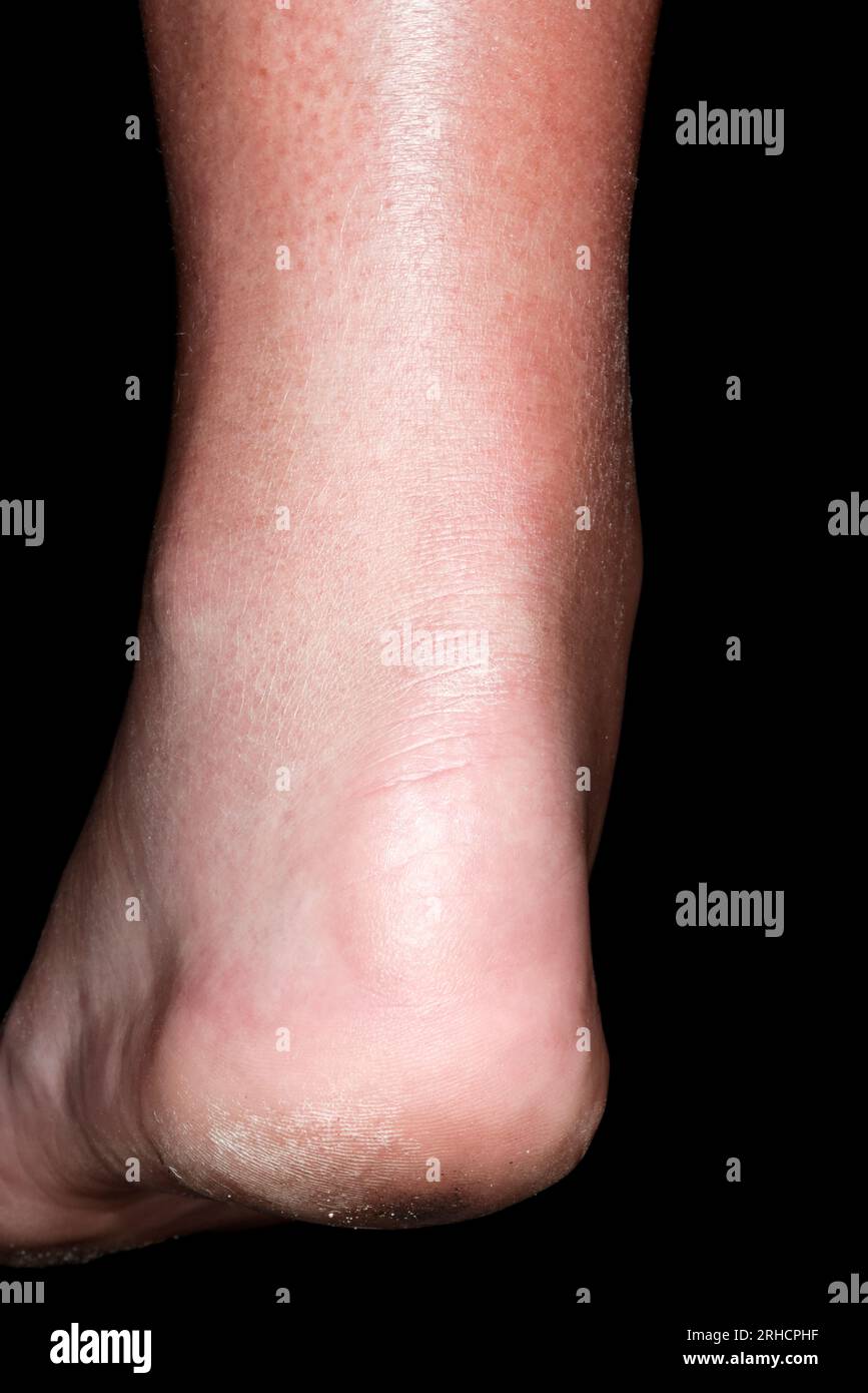 Ruptured Achilles tendon Stock Photo - Alamy