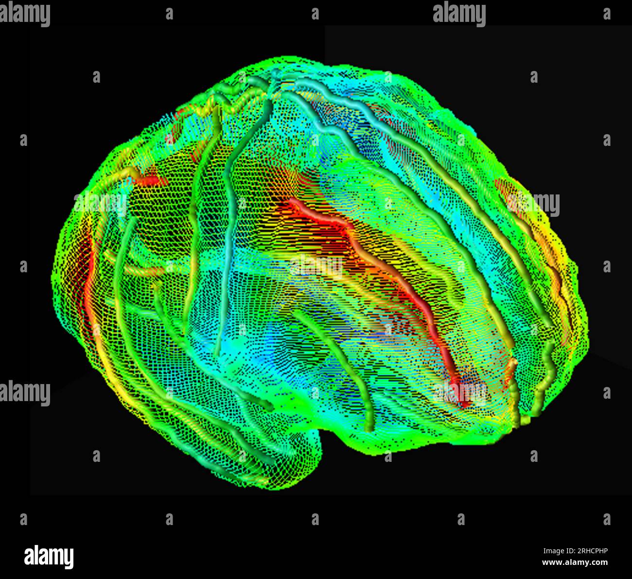 Brain in Alzheimer's disease, DTI MRI scan Stock Photo - Alamy
