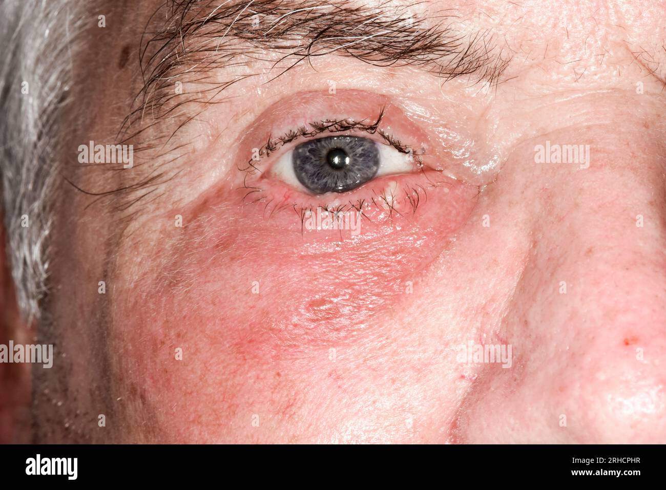 Blepharitis of the lower eyelid Stock Photo - Alamy