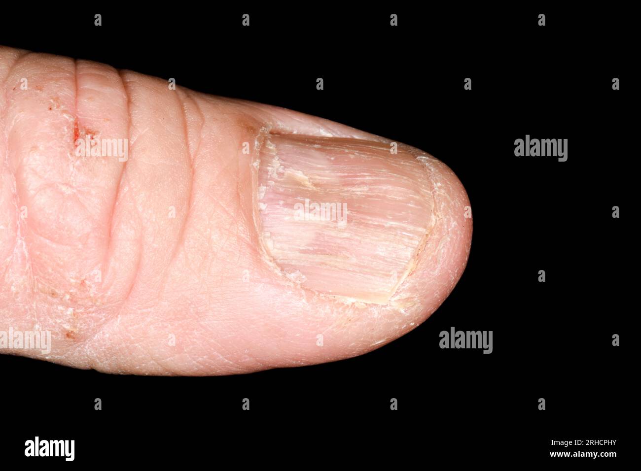 Psoriasis of the fingernail Stock Photo - Alamy