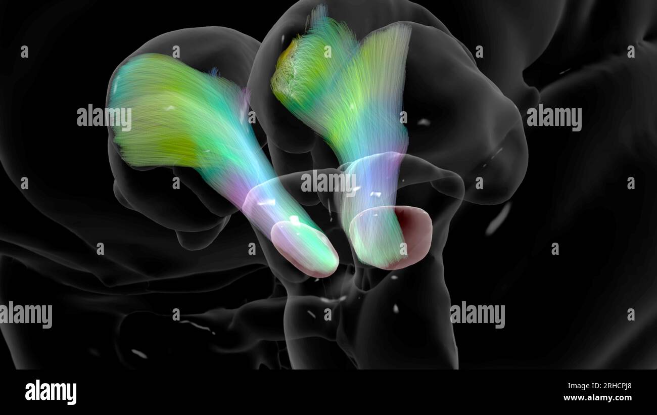 Substantia nigra in Parkinson's disease, DTI MRI scan Stock Photo - Alamy