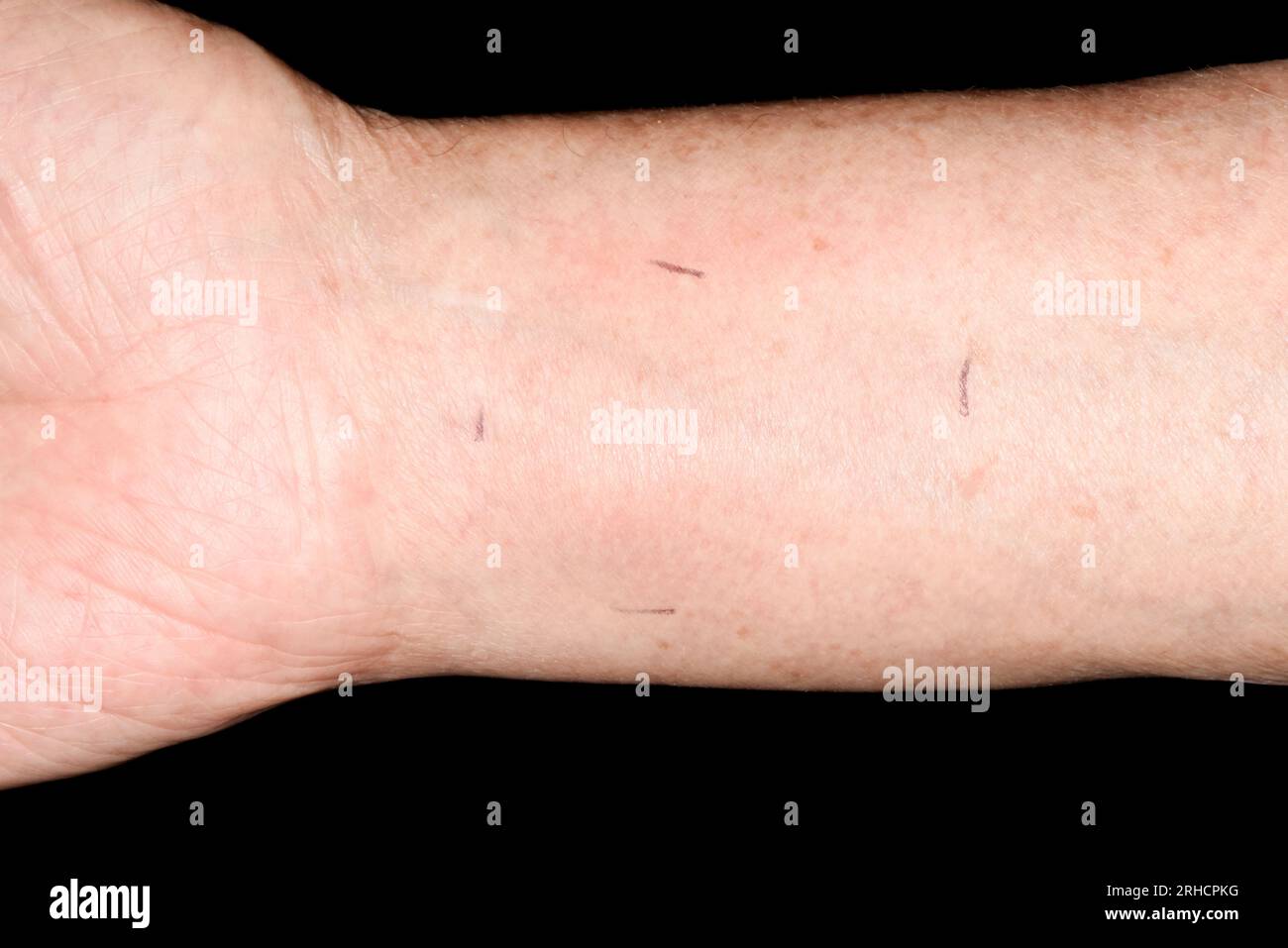 Swollen wrist after treatment for carpel tunnel syndrome Stock Photo ...