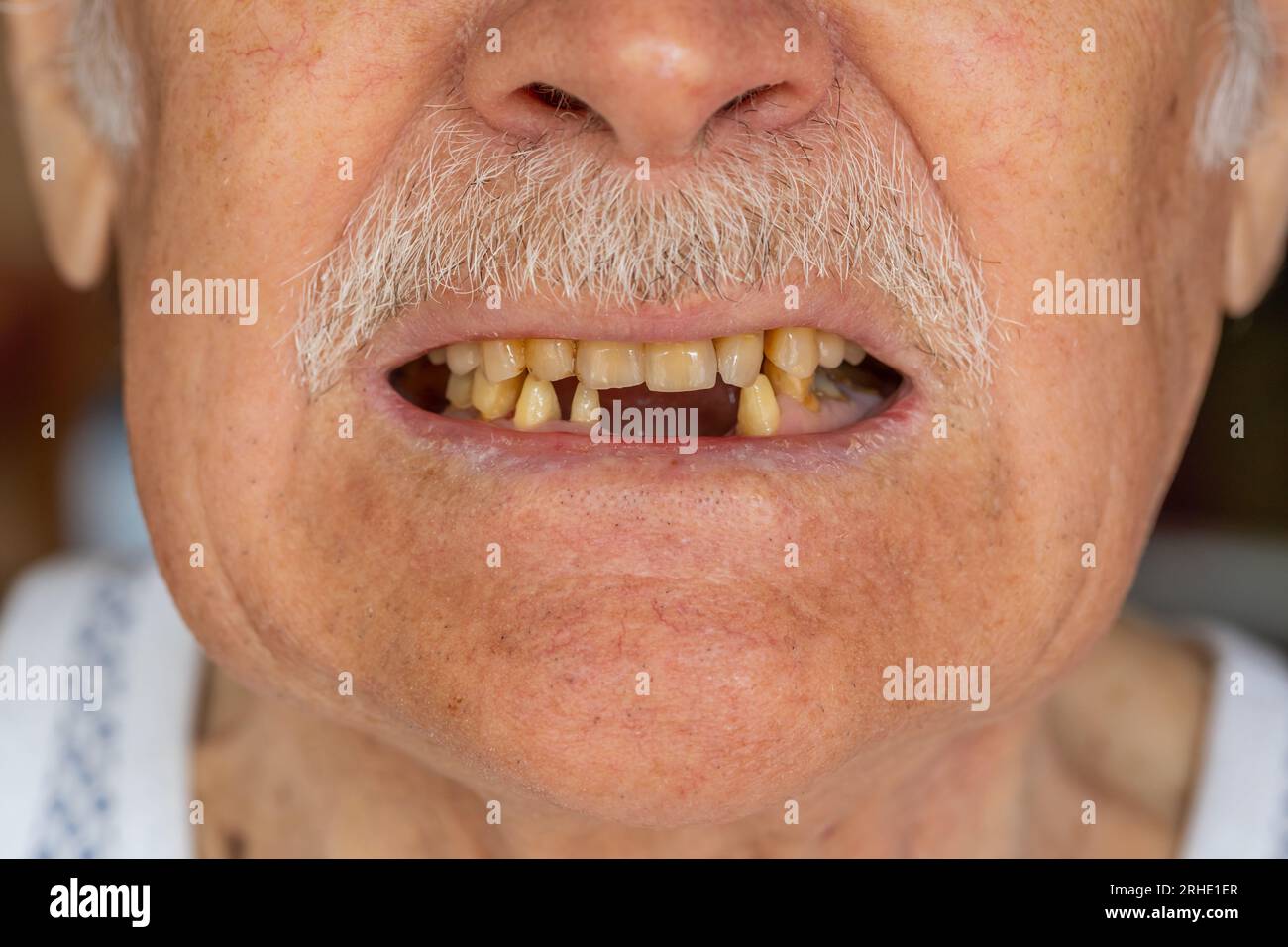 Tooth loss senior hi-res stock photography and images - Alamy