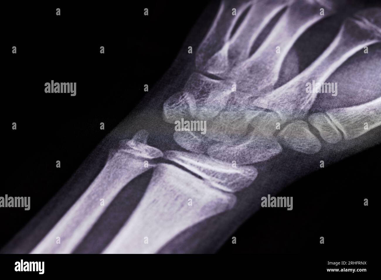 x-ray of the hands, detail of the phalanges and joints,trapeze,scaphoid ...