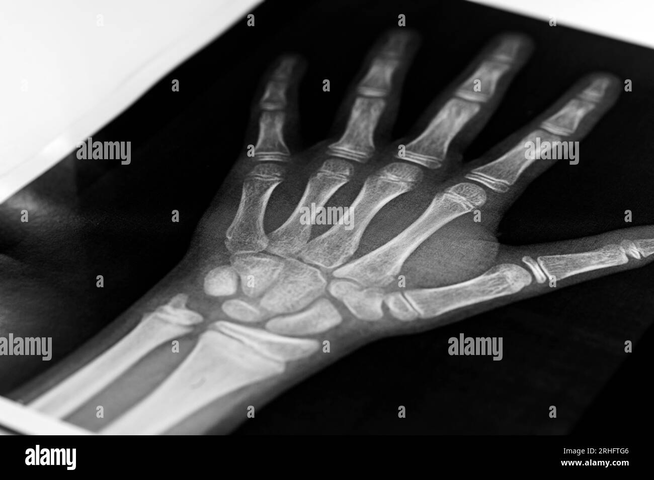 x-ray of the hands, detail of the phalanges and joints,trapeze,scaphoid ...