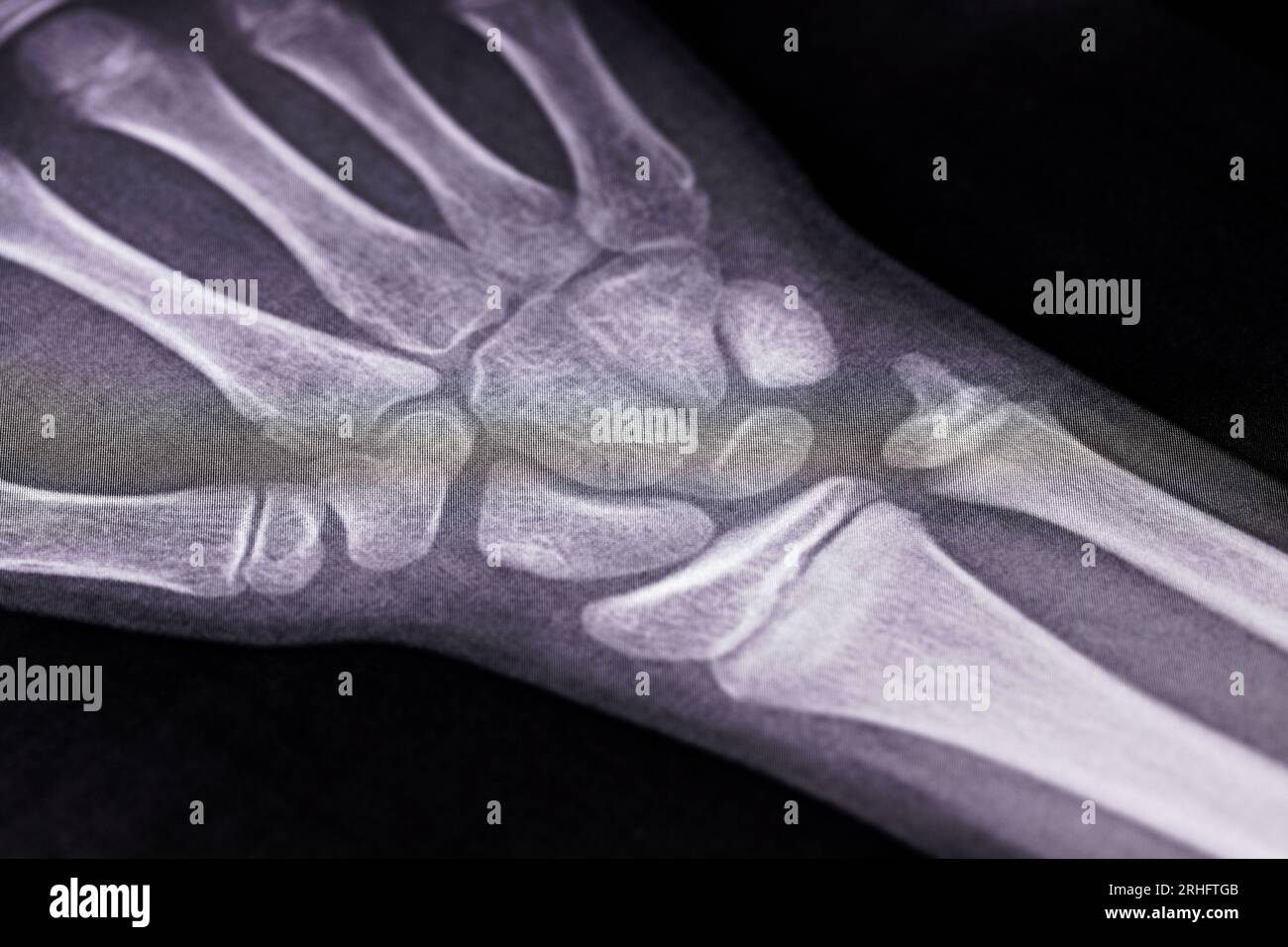 x-ray of the hands, detail of the phalanges and joints,trapeze,scaphoid ...