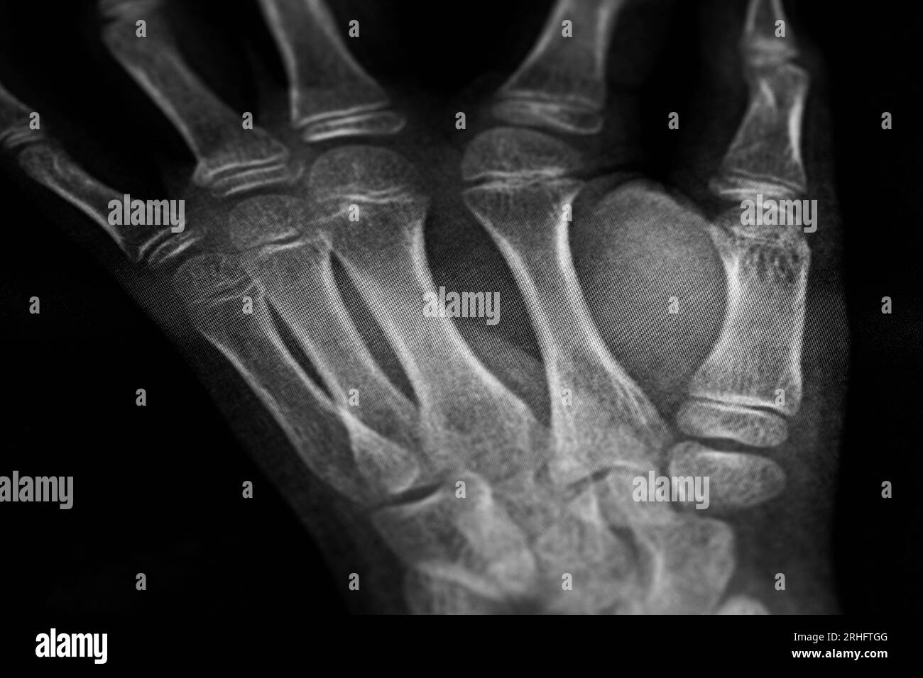 x-ray of the hands, detail of the phalanges and joints,trapeze,scaphoid ...