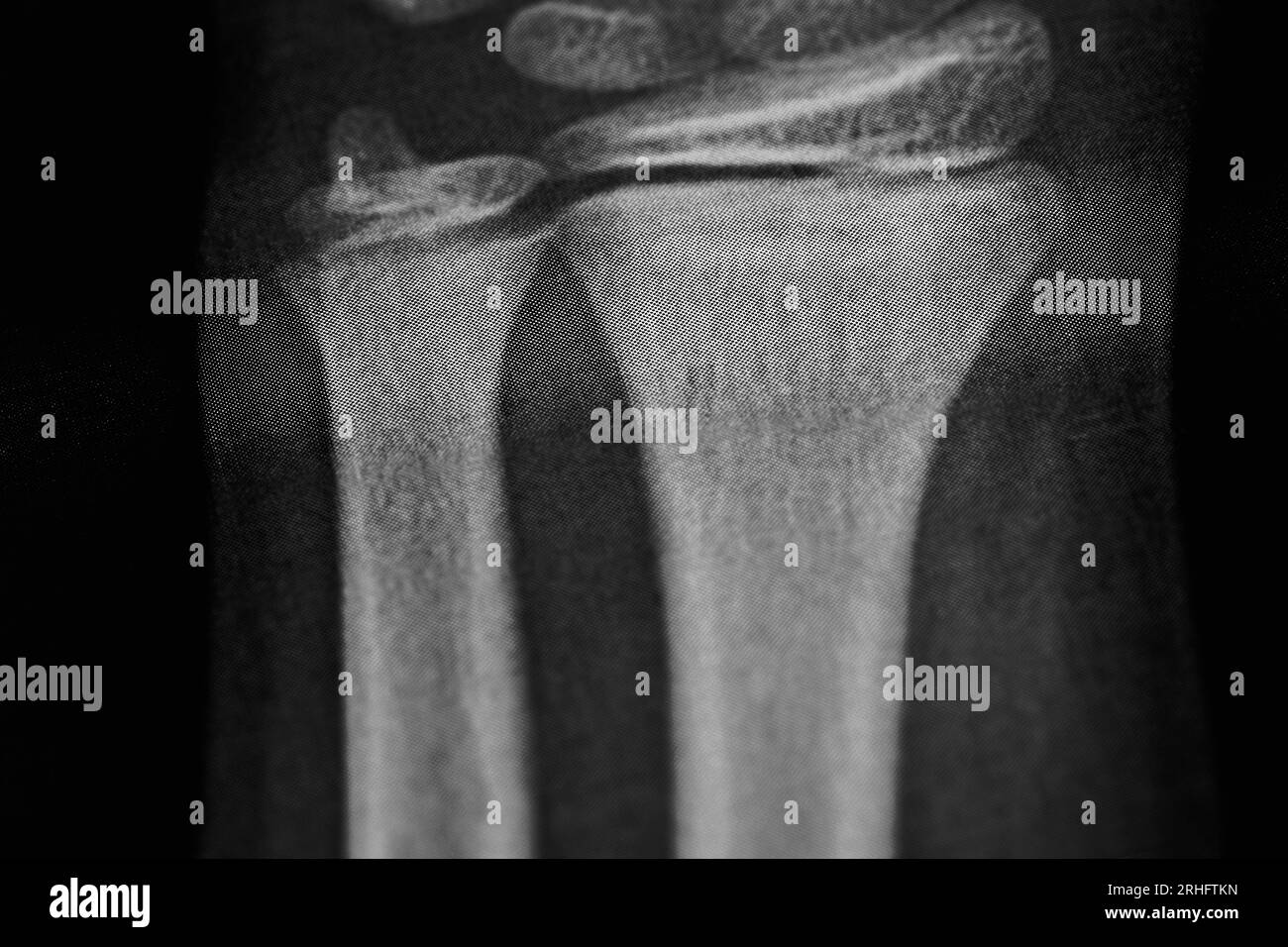 x-ray of the hands, detail of the phalanges and joints,trapeze,scaphoid ...