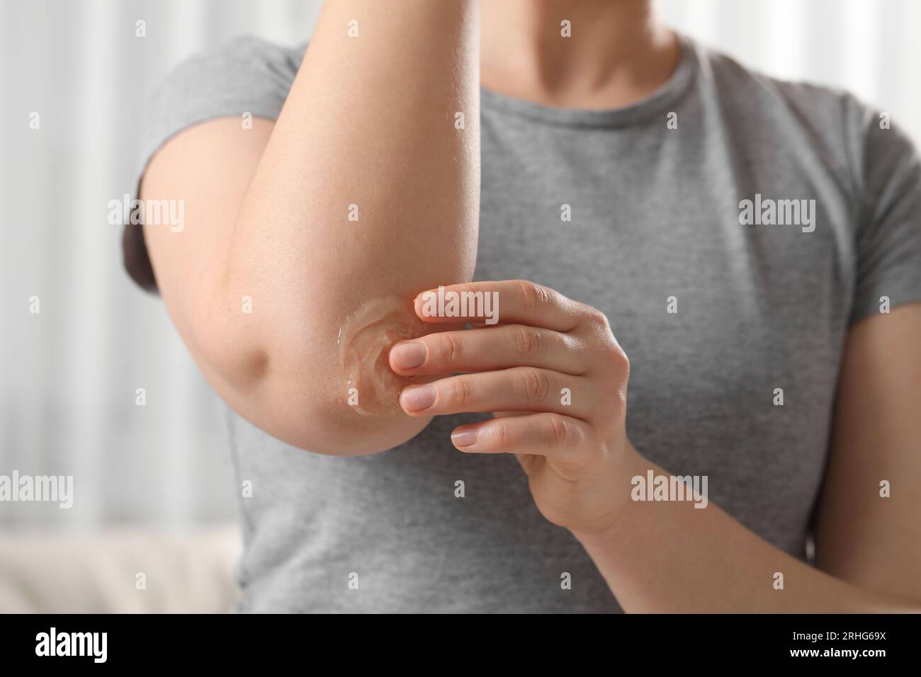 Ointment woman elbow hi-res stock photography and images - Alamy